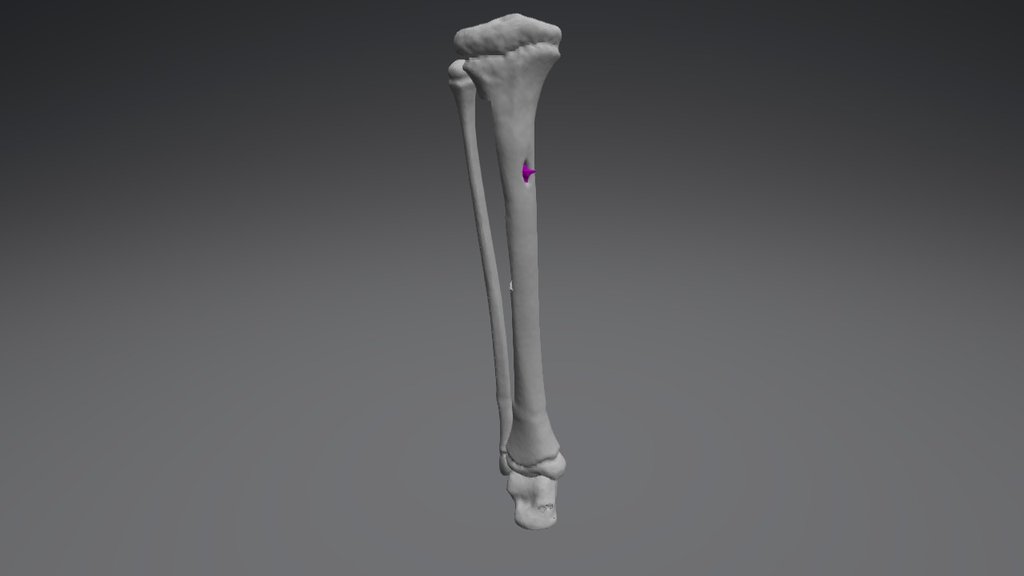 Tibial Sarcoma - 3D model by Nathan @ 3DM (@nathan.wang) [8d04859 ...