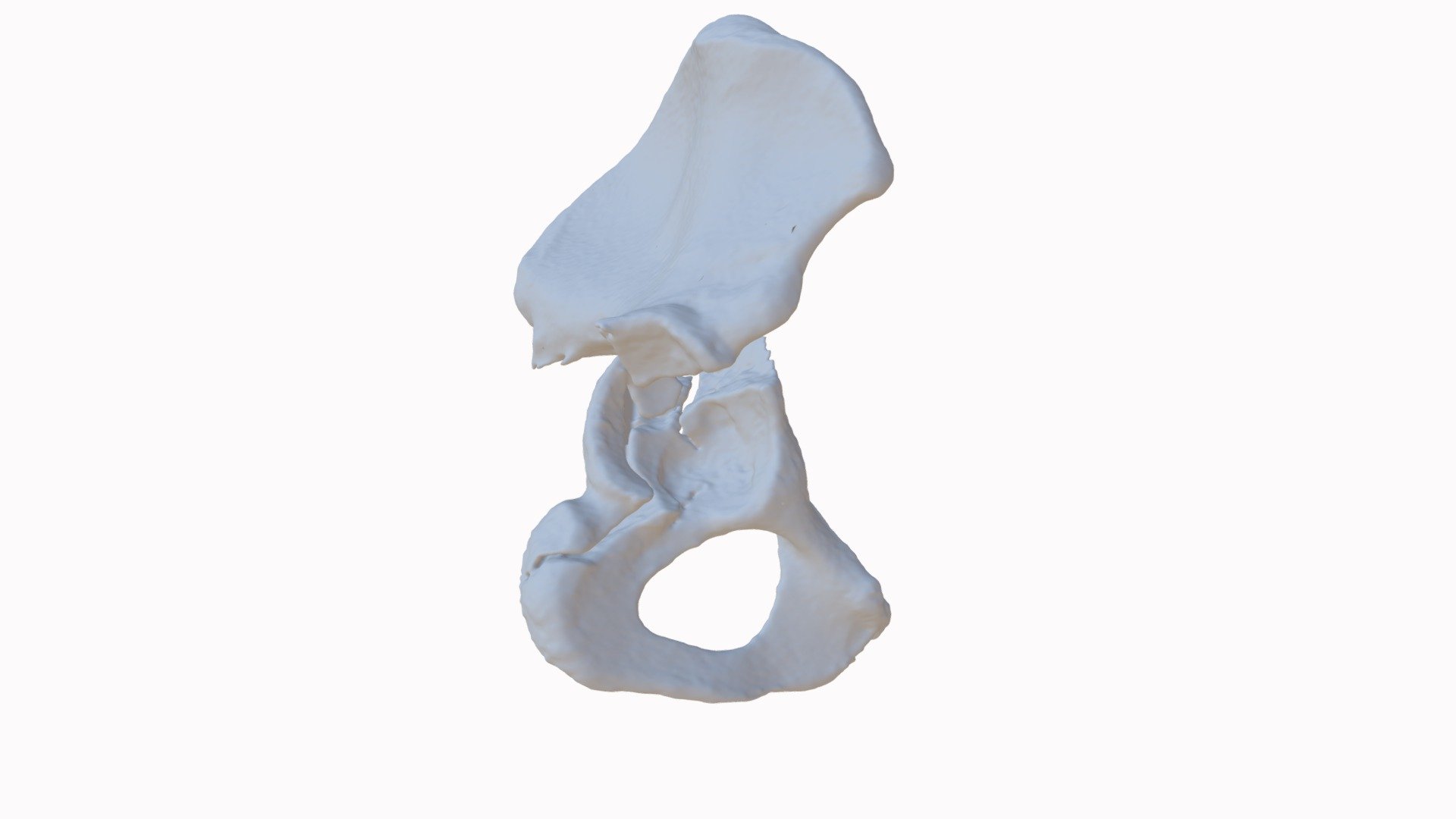 P00154 - Acetabular fracture - 3D model by Axial3D [8d8e6dd] - Sketchfab