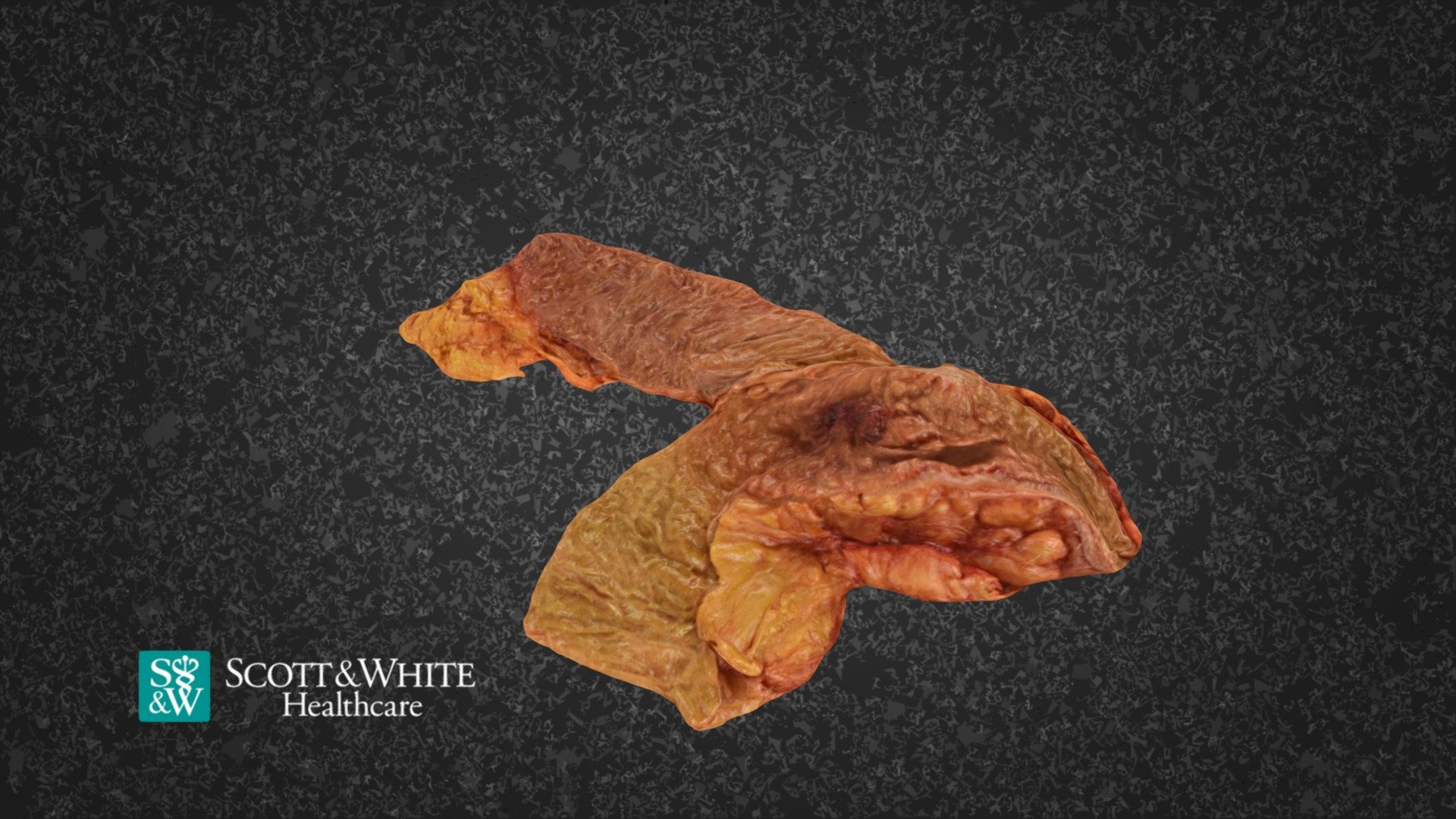 Sigmoid Adenocarcinoma 253336 - 3D model by Scott & White Moulage ...