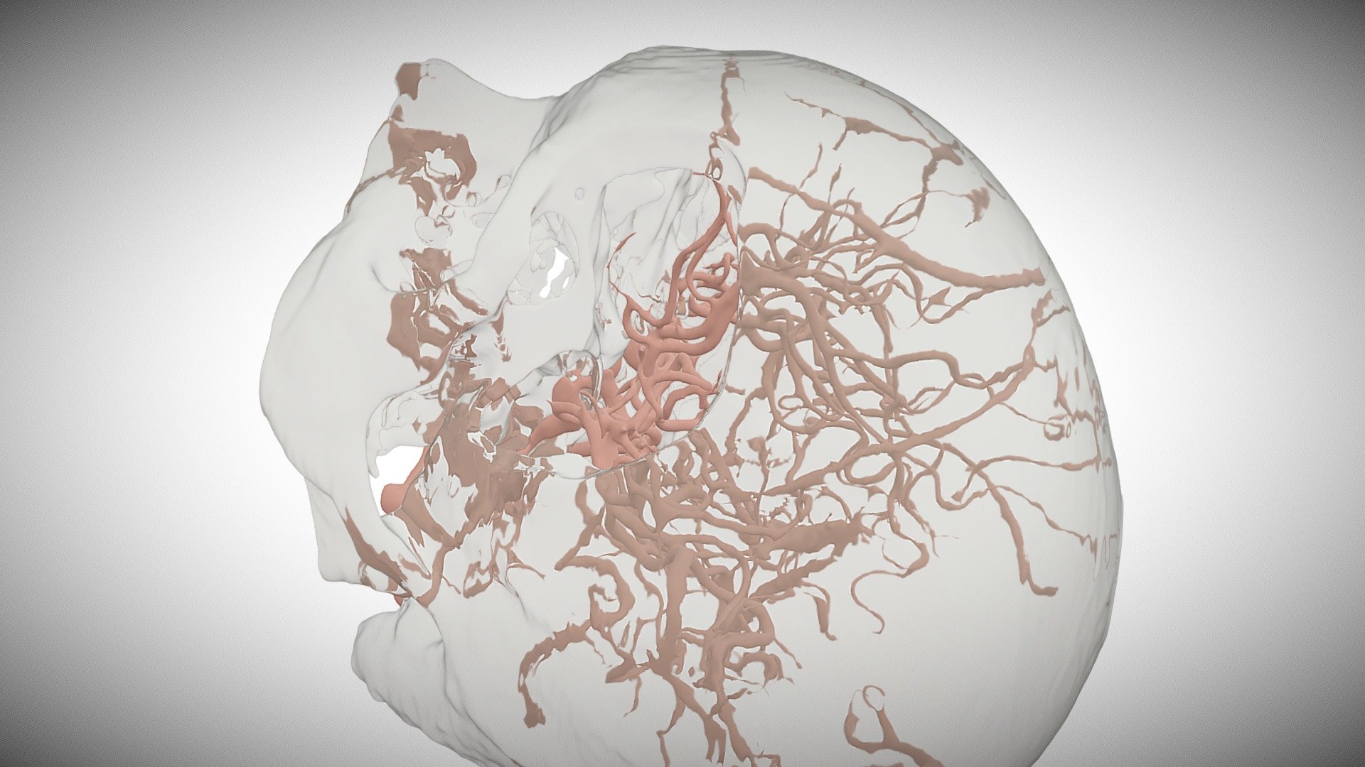 Pterional approach - 3D model by 3D Atlas of Neurological Surgery ...