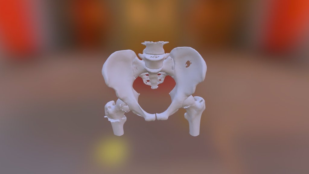 Acetabular Fracture - sku 238 - 3D model by orto3d [9175b36] - Sketchfab