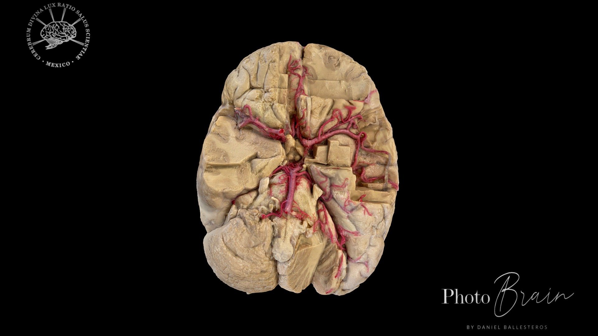 Circle of Willis - 3D model by Photobrain_mx [92f5190] - Sketchfab
