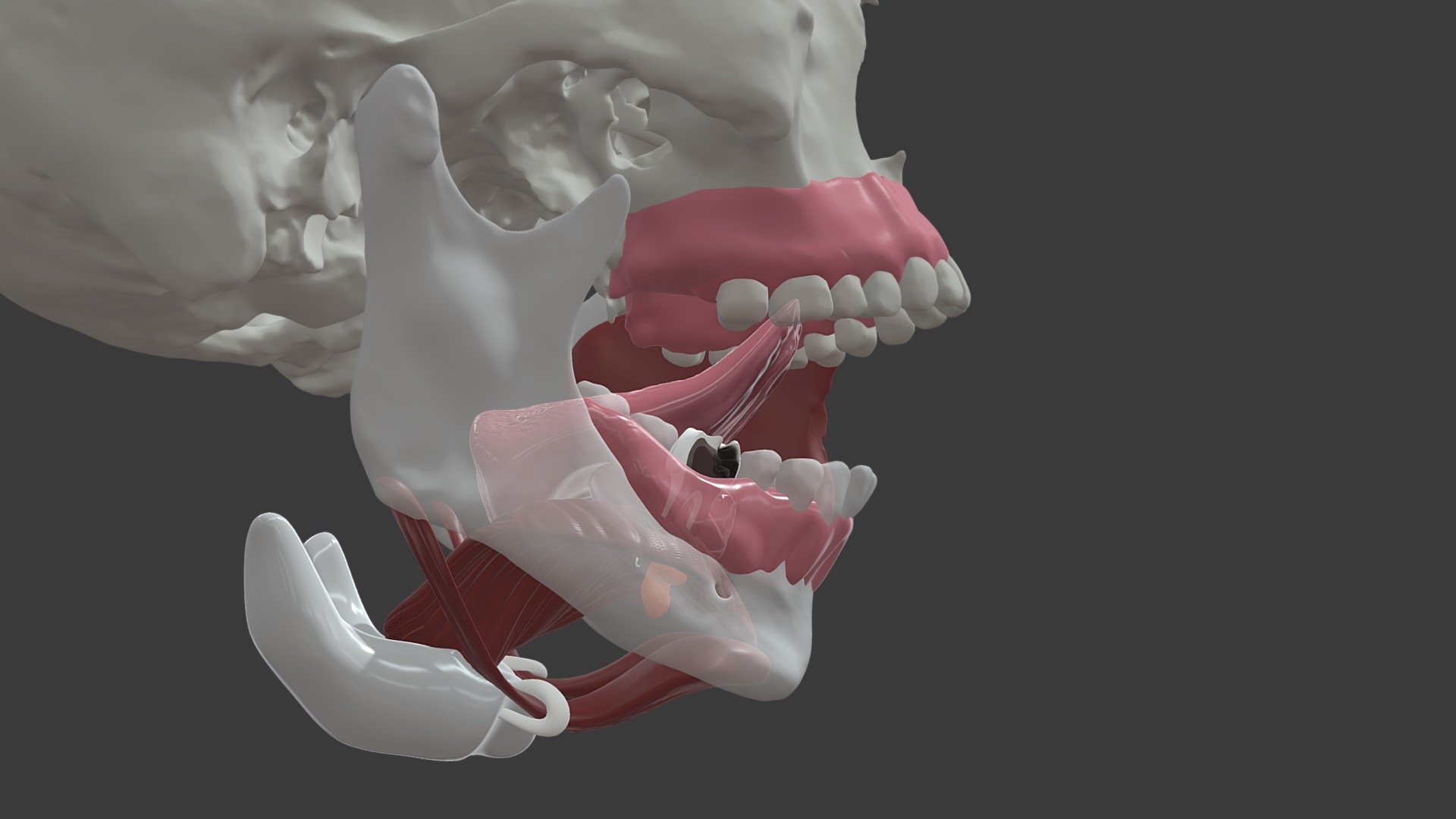 Stage 4 - Mandibular Molar Infection pathway 4 - 3D model by University ...