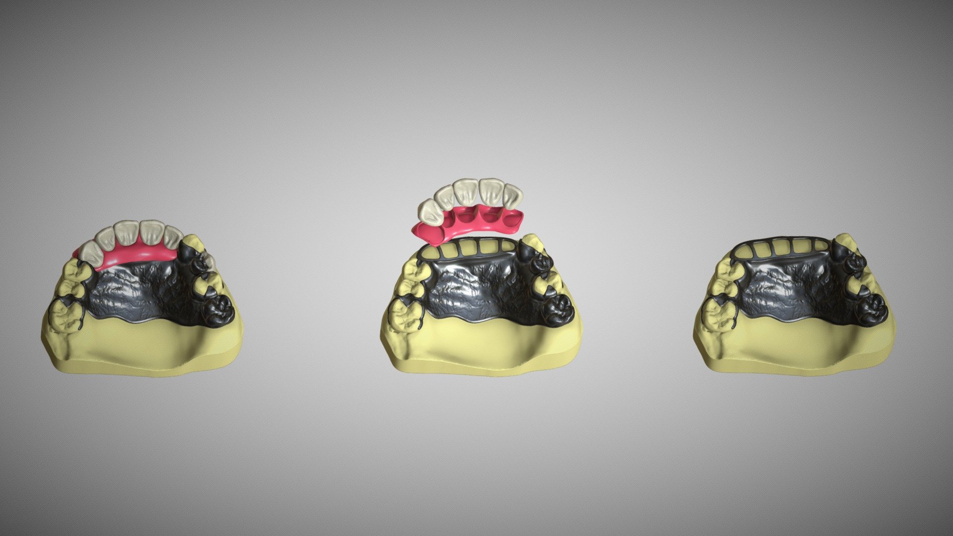 Kennedy Class II Mod 2 Design (Maxillary) - 3D model by Muhammad Nabeel ...