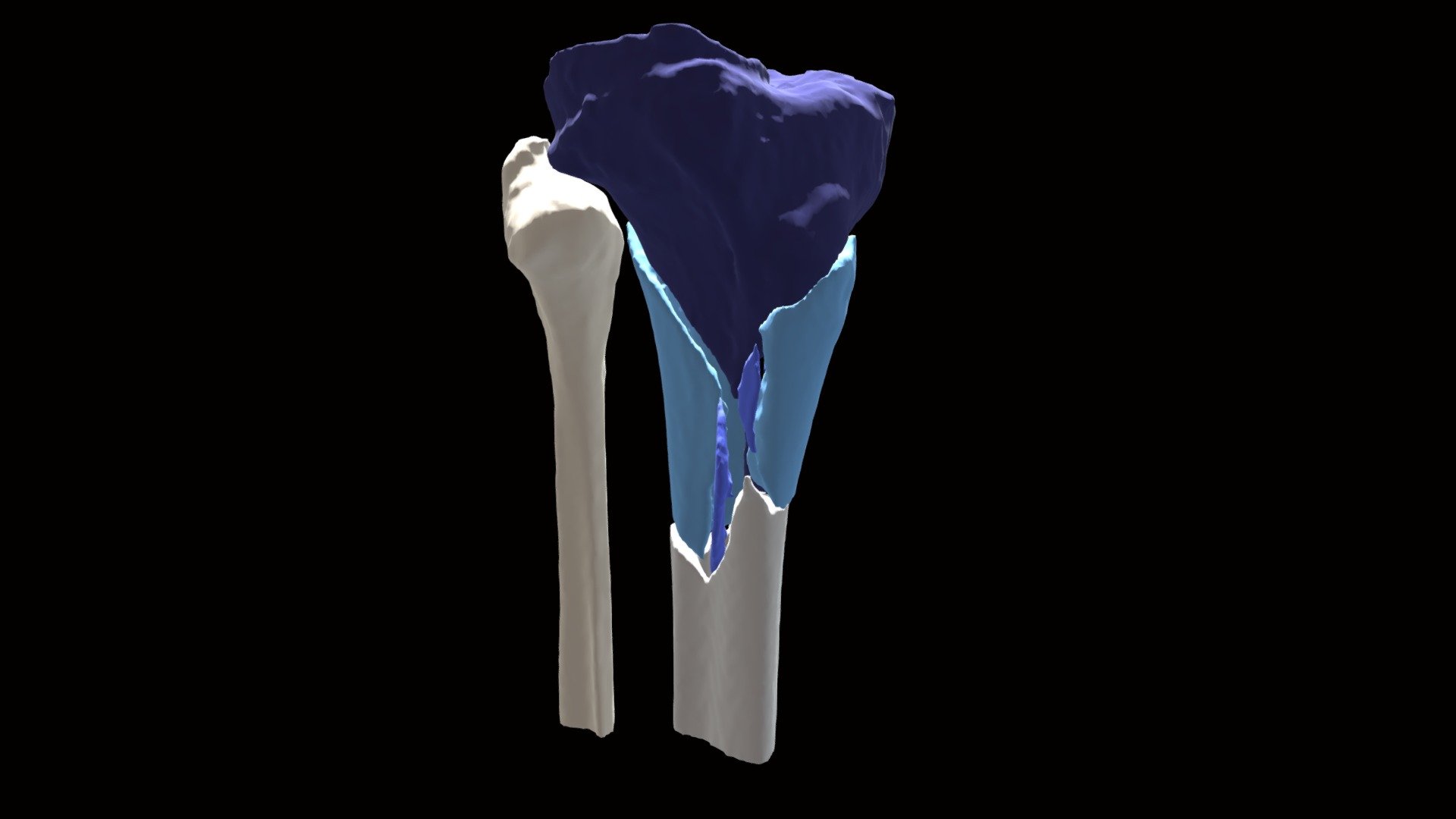 WST Festival 2023 | Proximal Tibia Fractures - Download Free 3D model ...