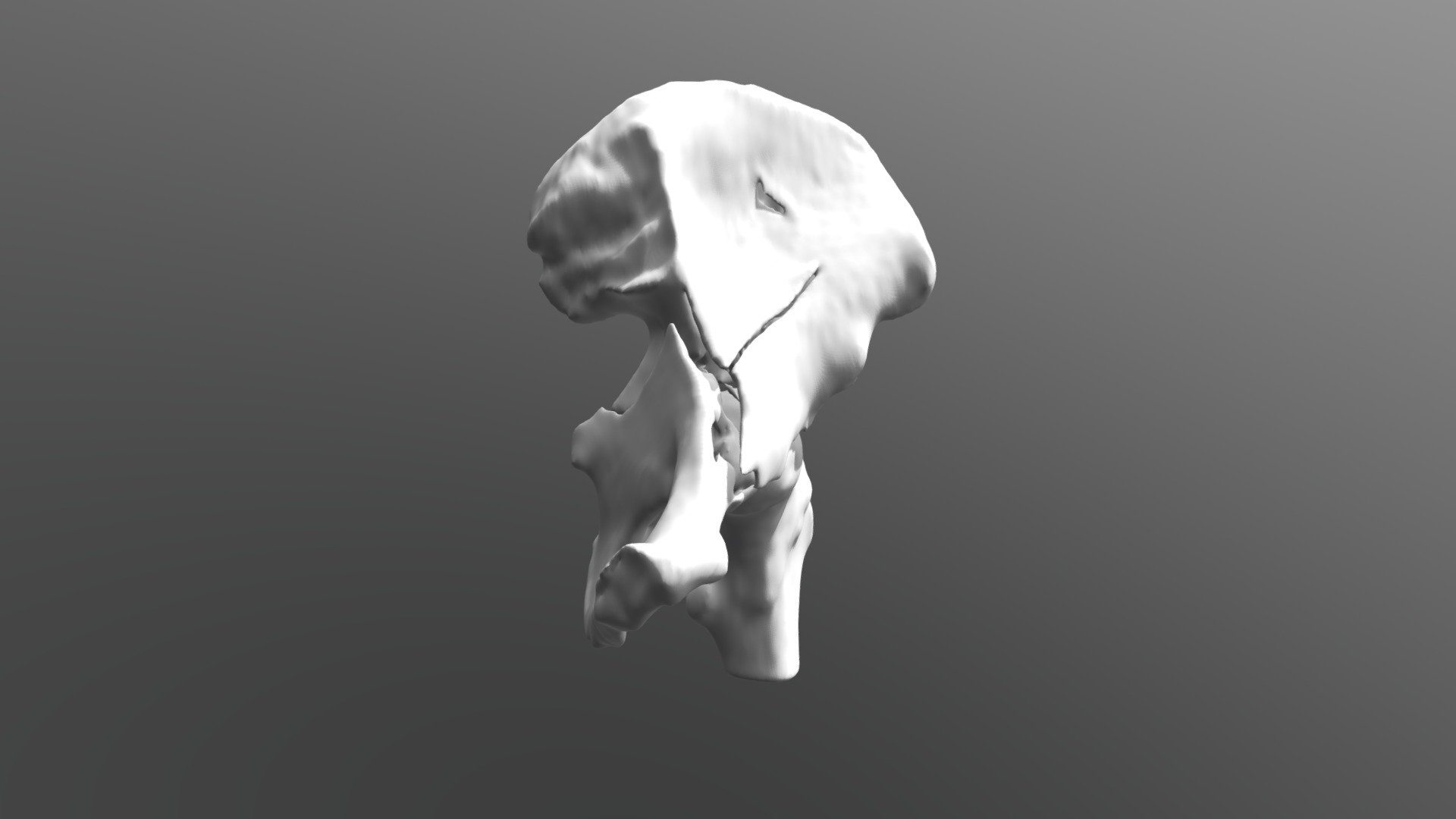 Acetabular fracture of the left hip - 3D model by valchanov [94b4012 ...