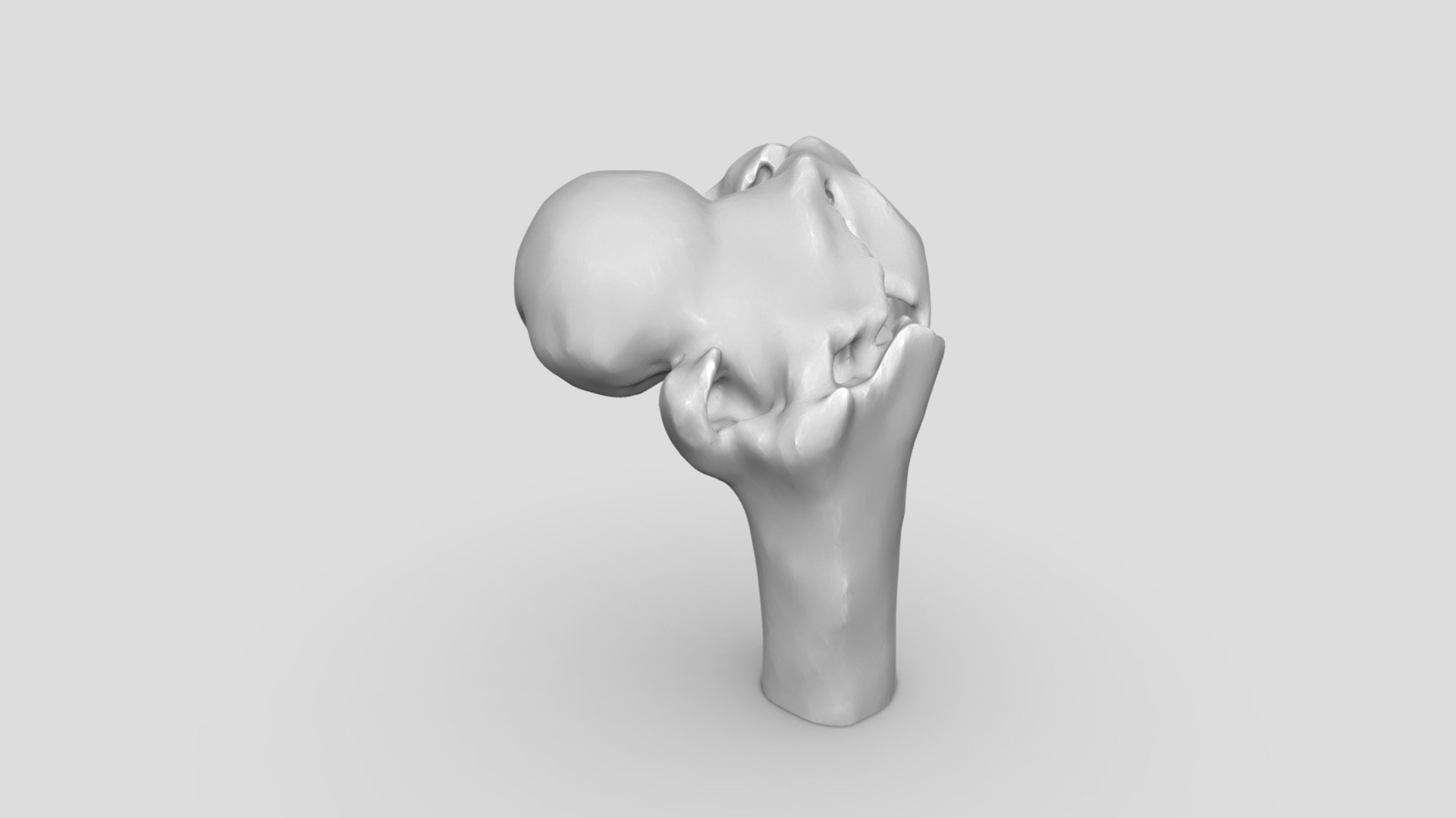 Femoral neck fracture - 3D model by Qubx.3D (@mostafas) [95b2c53 ...