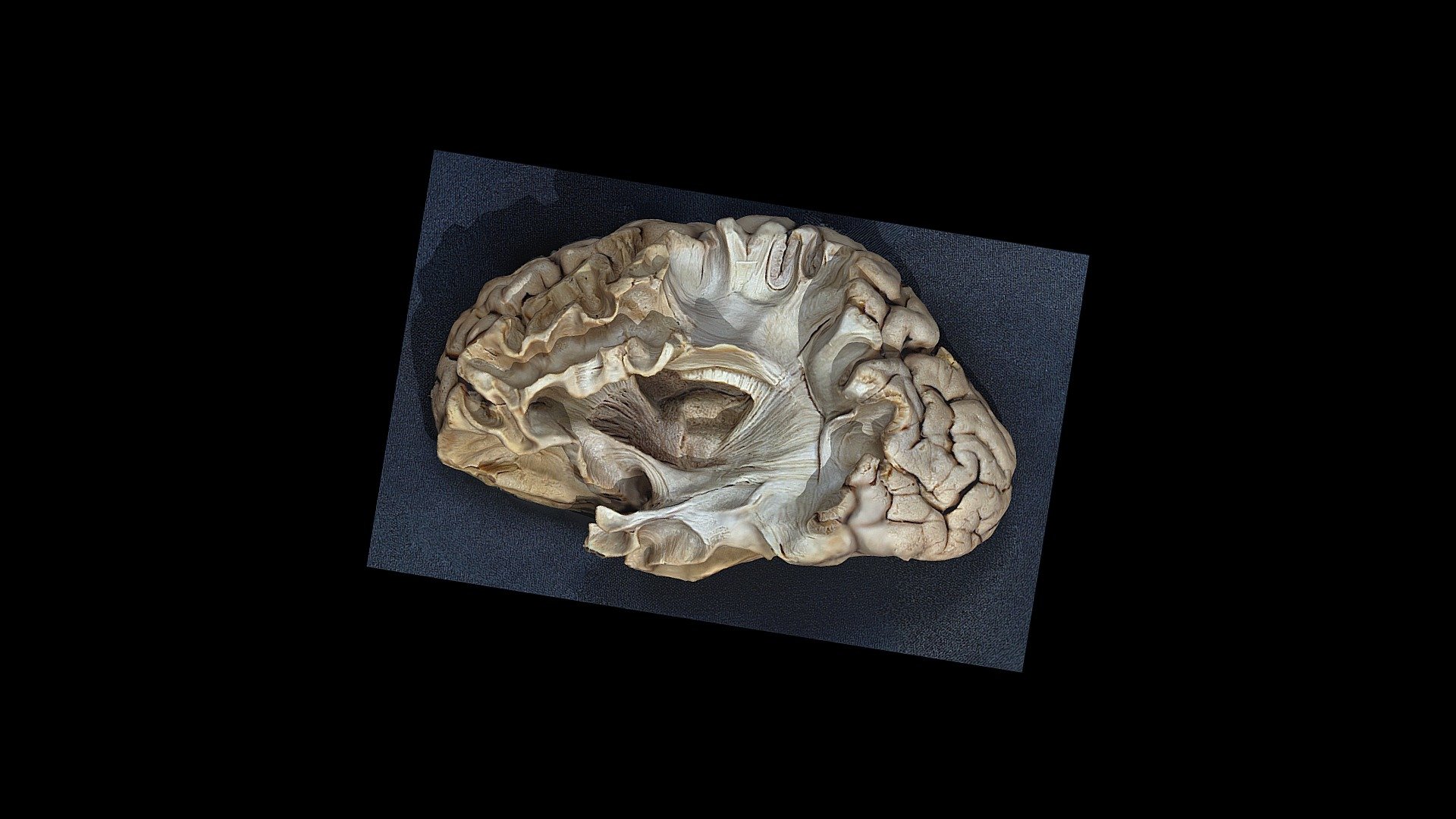 Thalamus and Caudate Nucleus - 3D model by Istanbul-Microneurosurgery ...
