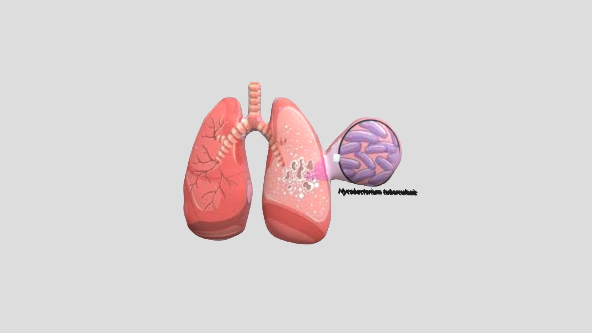 Tuberculosis - Download Free 3D model by Rara (@raudah) [964c010 ...