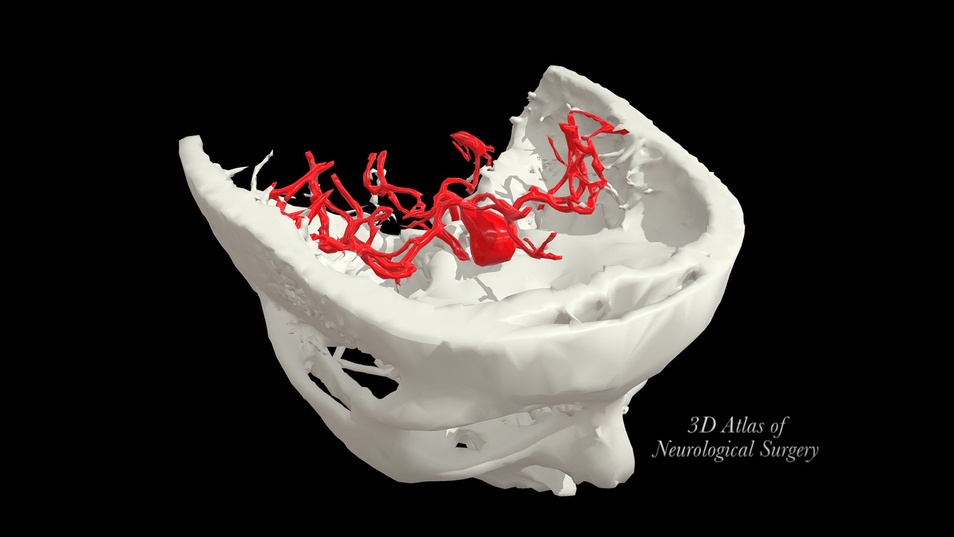 Figure 1 From Anterior Communicating Artery Aneurysm