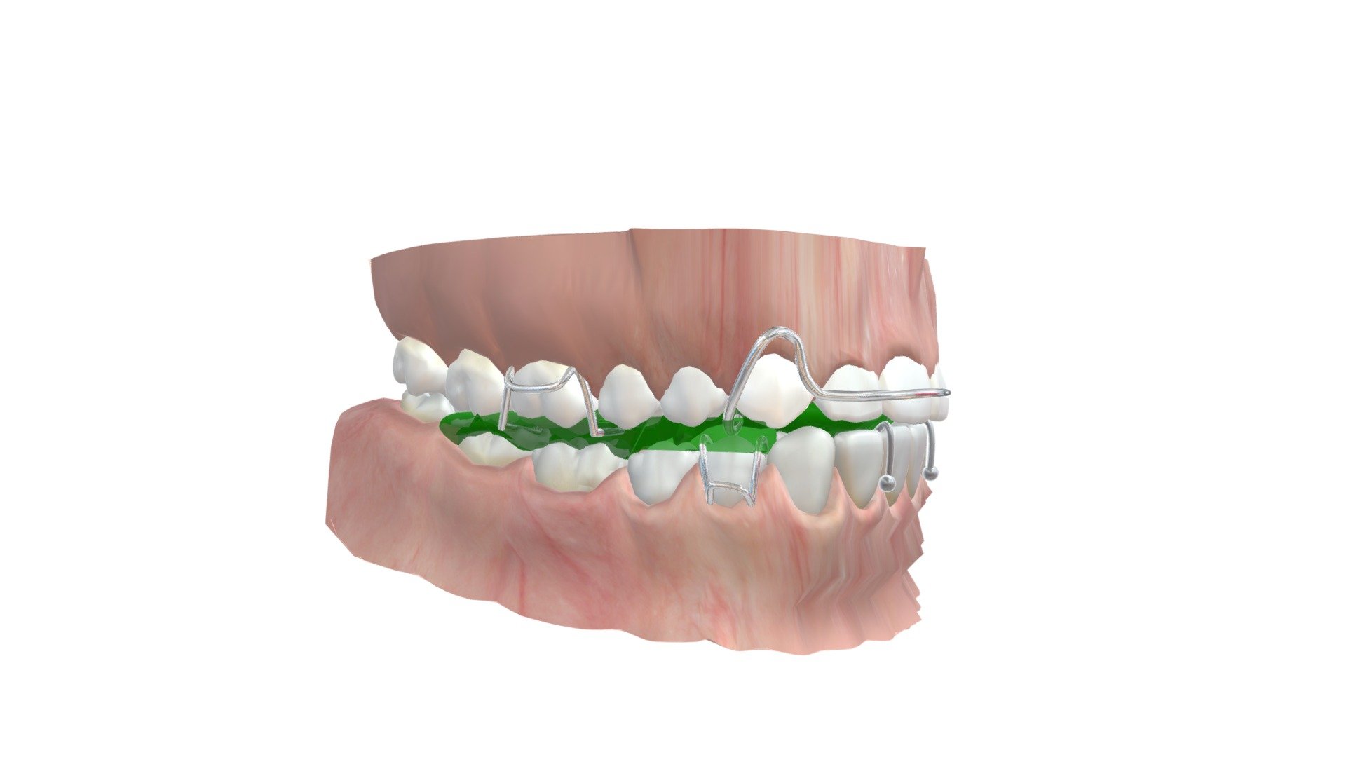 5. Twin Block Applicance - 3D model by Interactive 3D Data ...