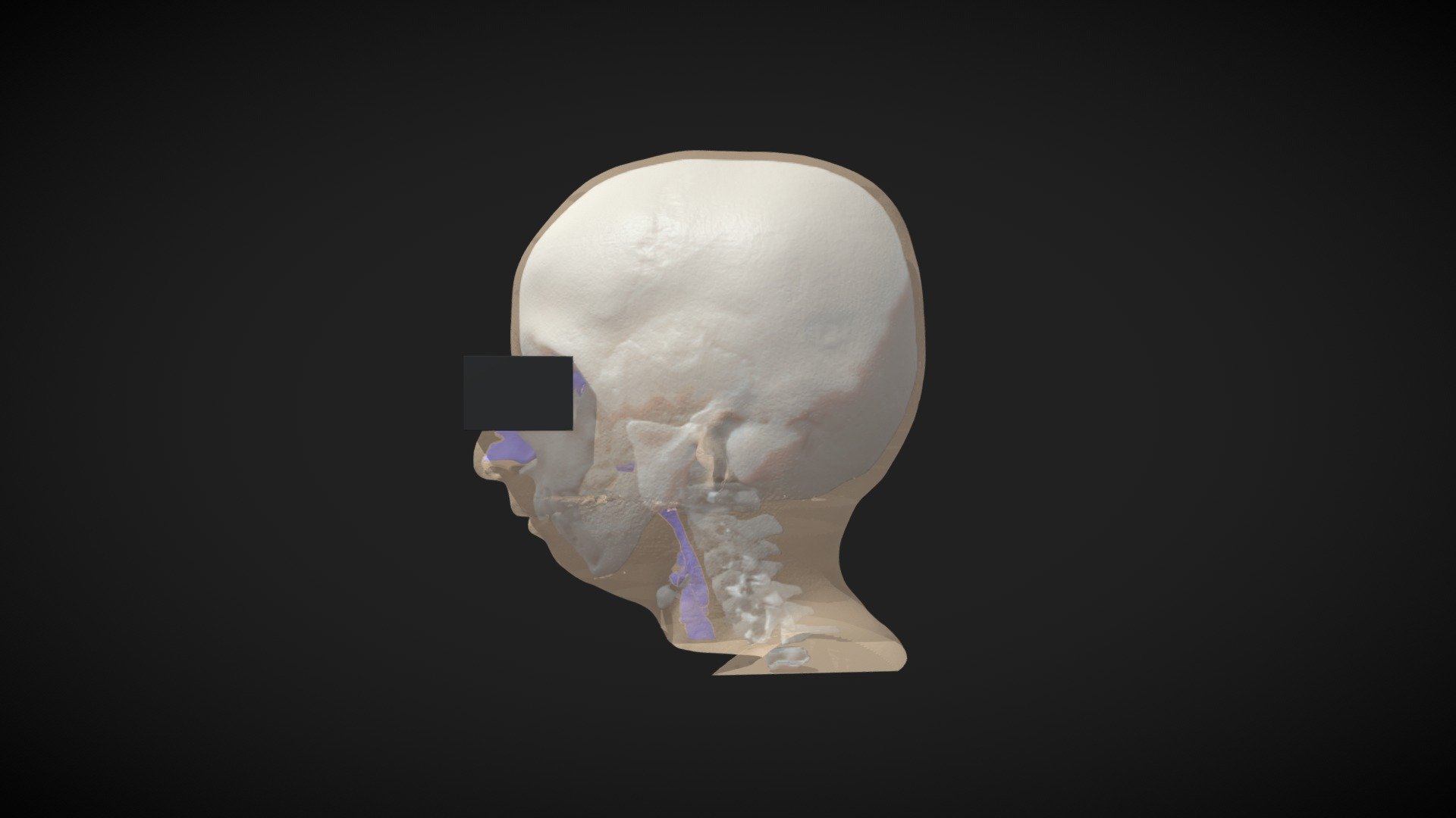 Treacher-Collins airway - 3D model by Lincoln Wong (@lincolnwong ...