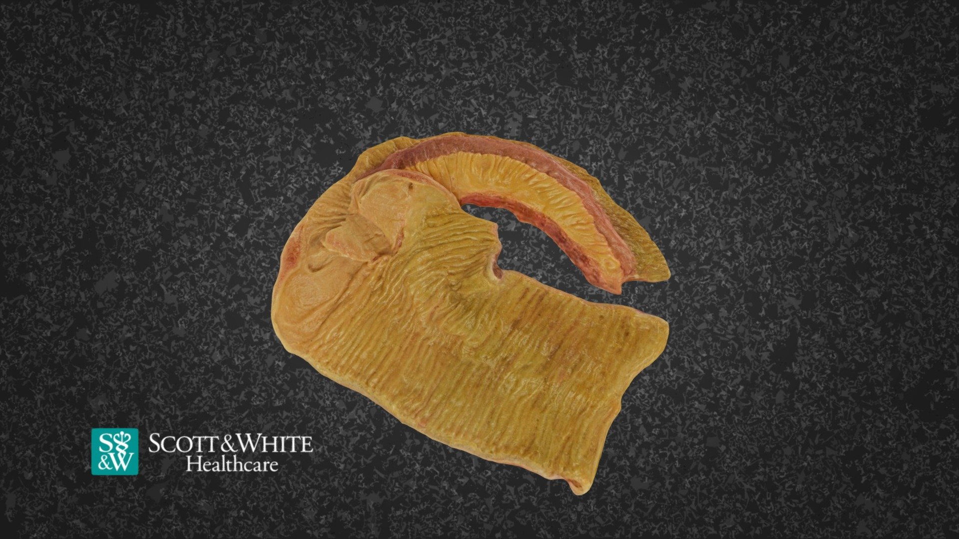 Lymphocytic Ileum 282057 - 3D model by Scott & White Moulage Project ...