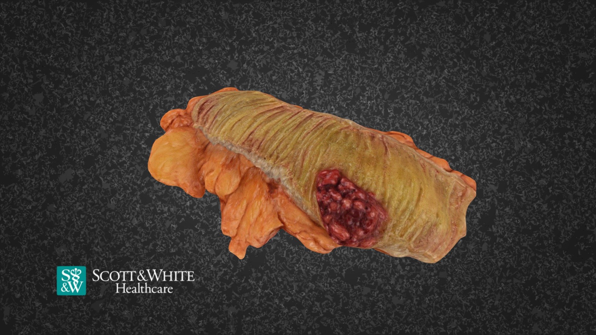 Colon- Villous Polyp 63499 - 3D model by Scott & White Moulage Project ...