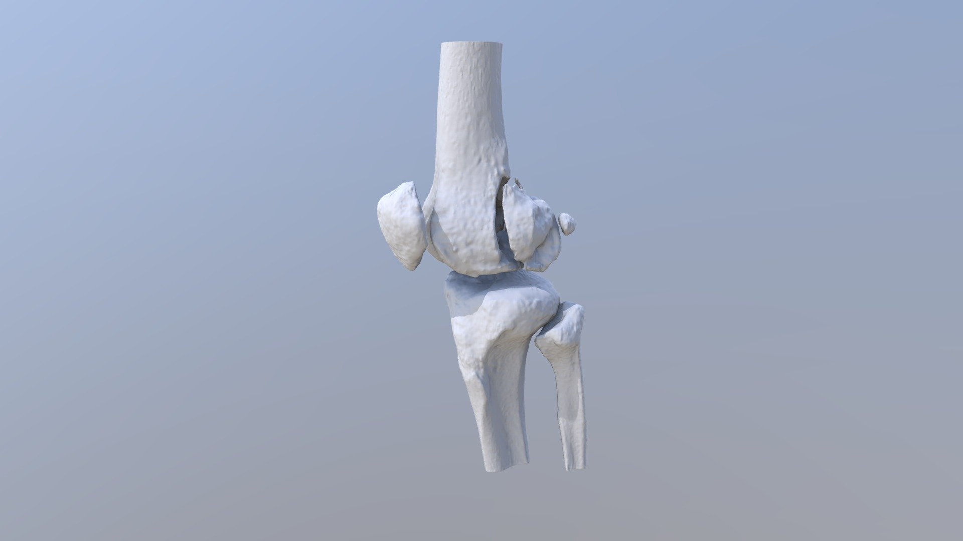 Multifragmentary fracture of the lateral condyle - 3D model by Innowise ...