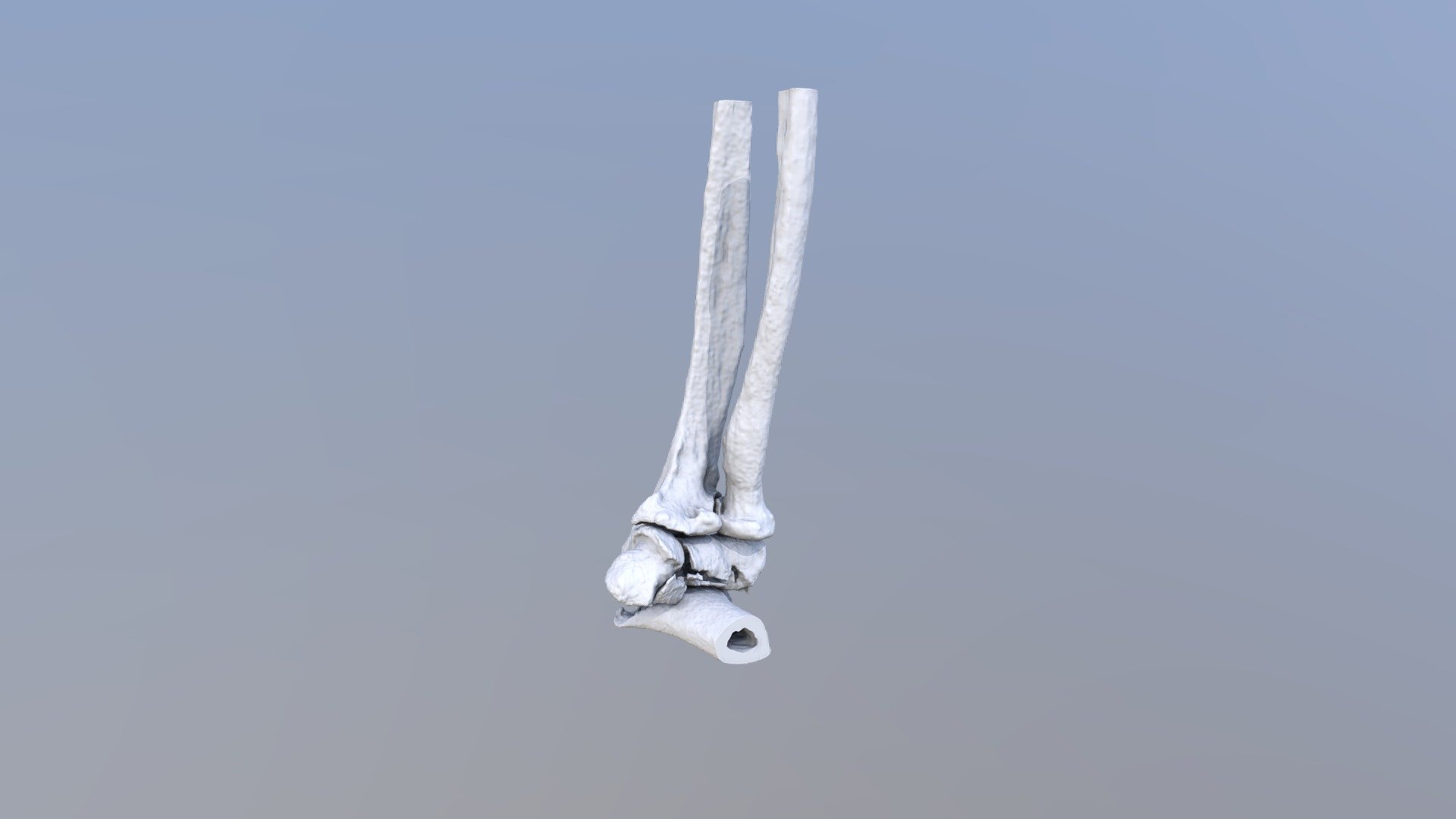 Сomminuted fracture of the distal humerus - 3D model by Innowise: VOKA Trauma Pathologies 3D ...
