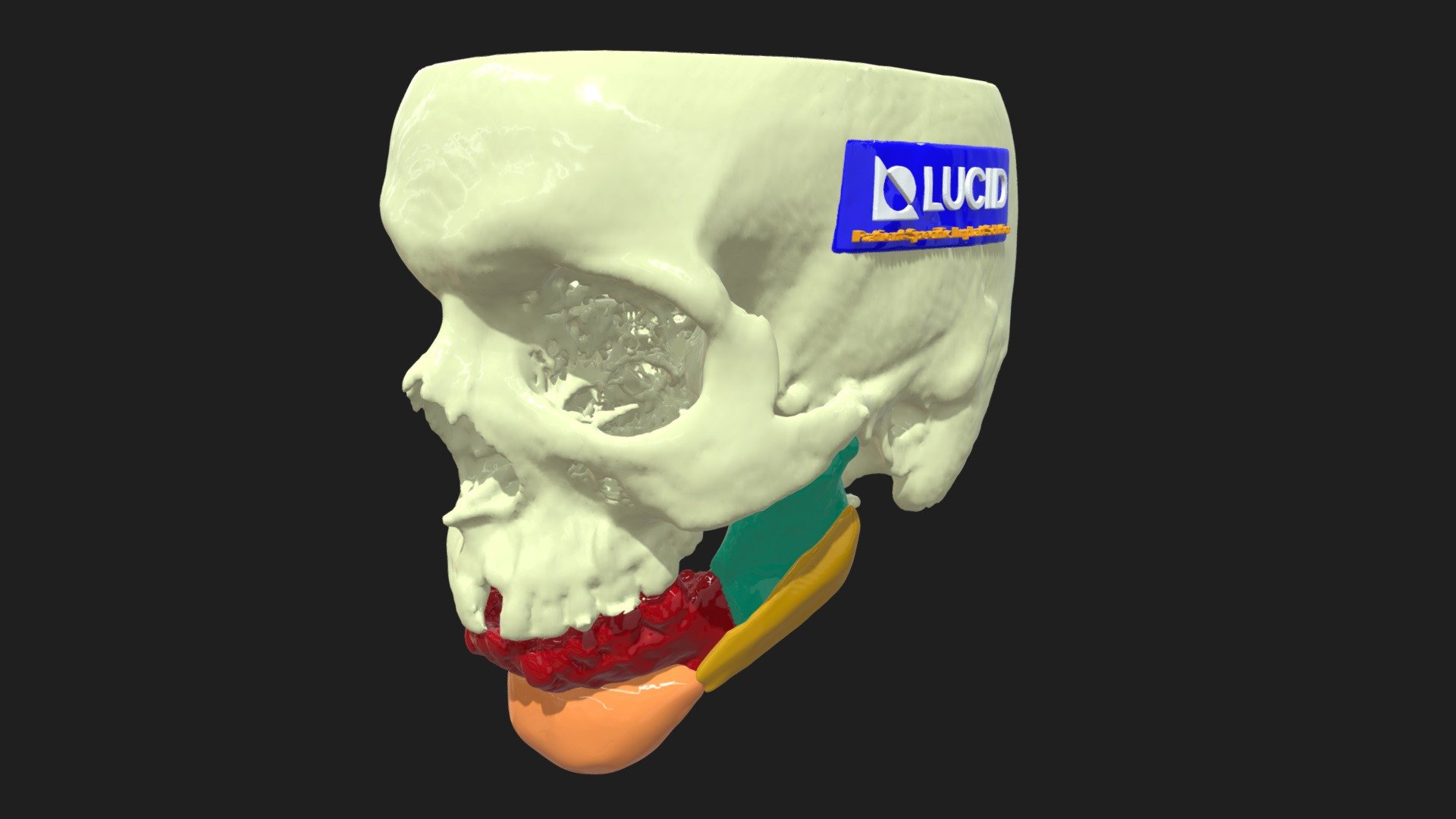 Case ID: 31207331 - Download Free 3D model by LUCID Implants (@LUCID_Implants) [98986eb] - Sketchfab
