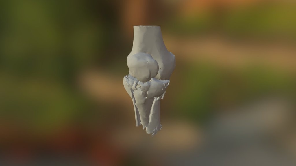 Knee - Proximal Tibia Fracture sku 026 - 3D model by orto3d [99186b2 ...