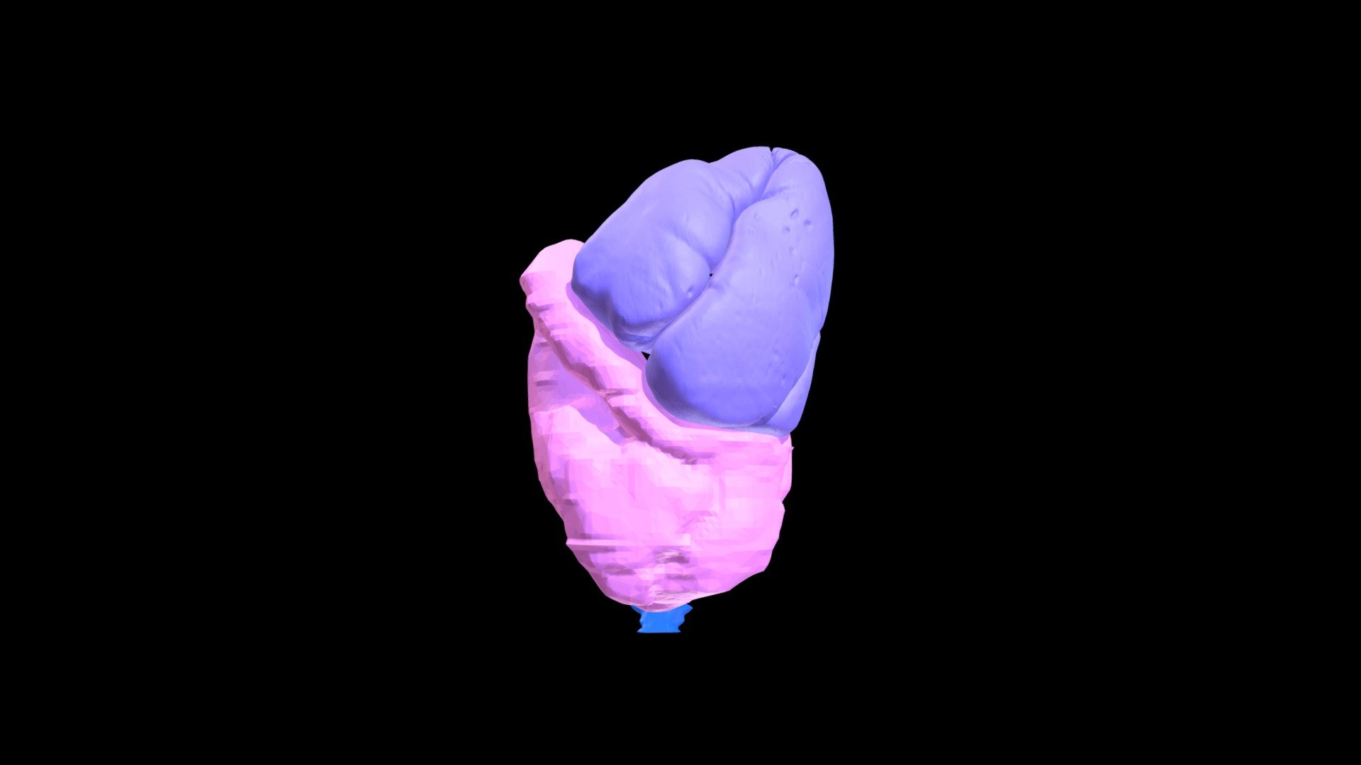 Sigmoid Volvulus - 3D model by Lincoln Wong (@lincolnwong) [996b509 ...