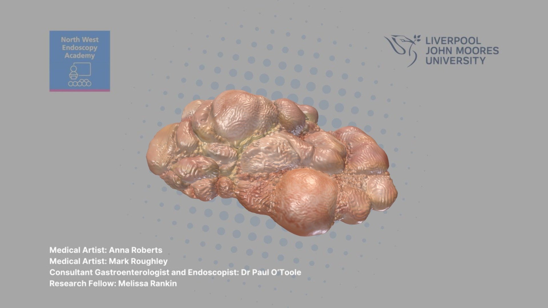 Lateral Spreading Type:Granular (Mixed Nodular)© - 3D model by ...