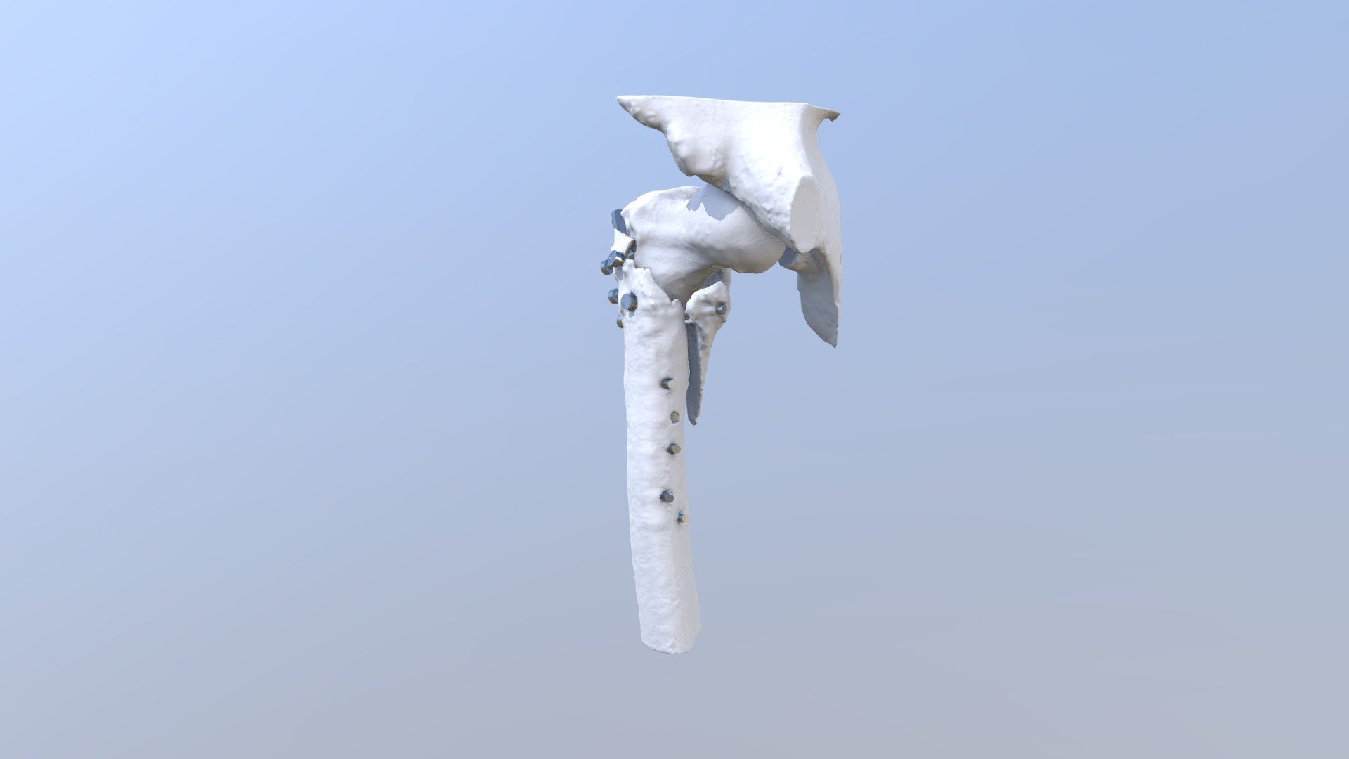 Comminuted proximal tibia fracture (19.07.AD) - 3D model by Innowise ...