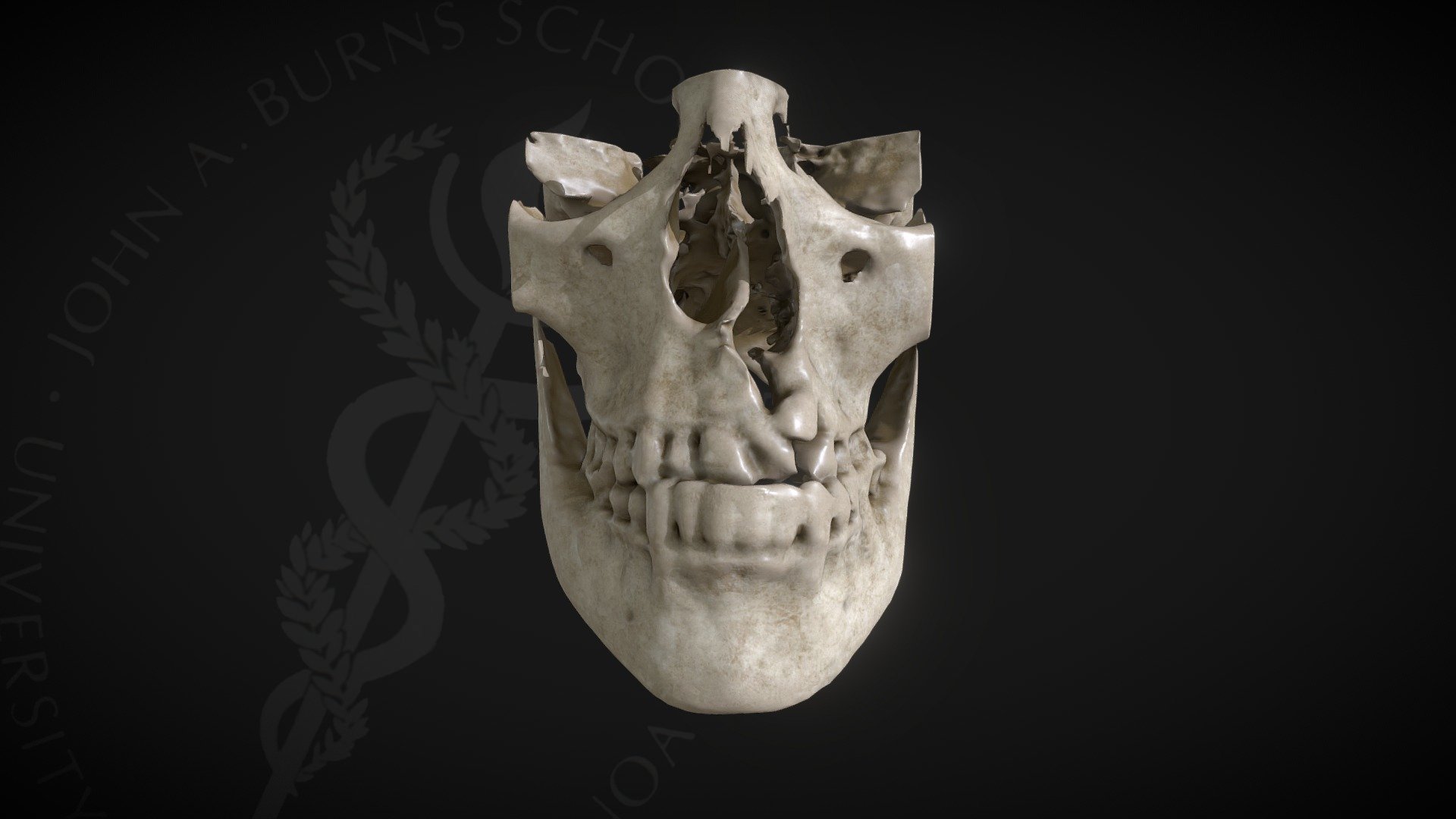 Skull Left Unilateral CLP Textured - 3D model by John A Burns School of ...