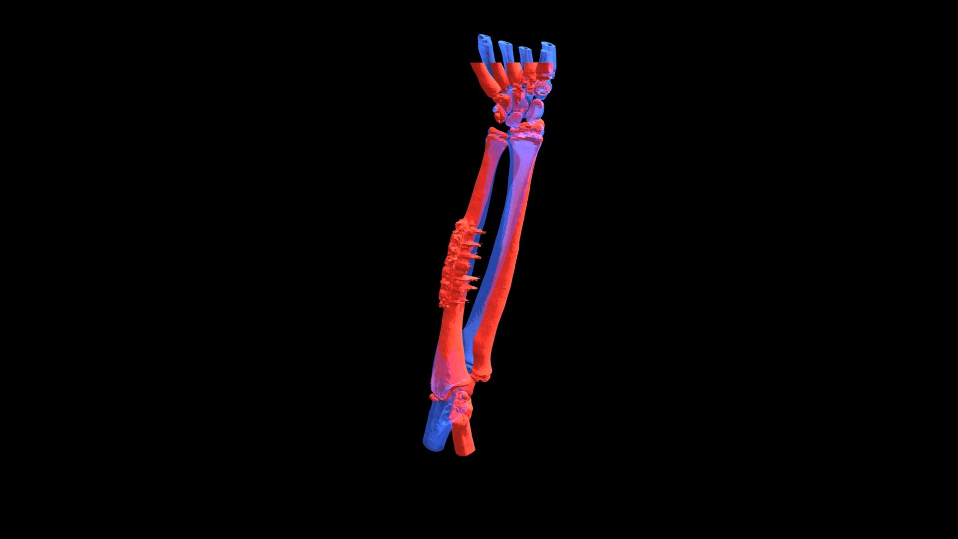 Forearm deformity overlay - 3D model by Lincoln Wong (@lincolnwong ...