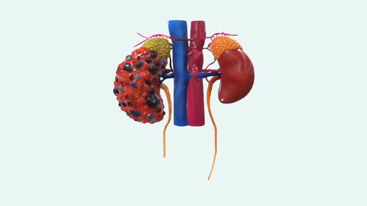 Polycystic_kidney_disease 3D models - Sketchfab