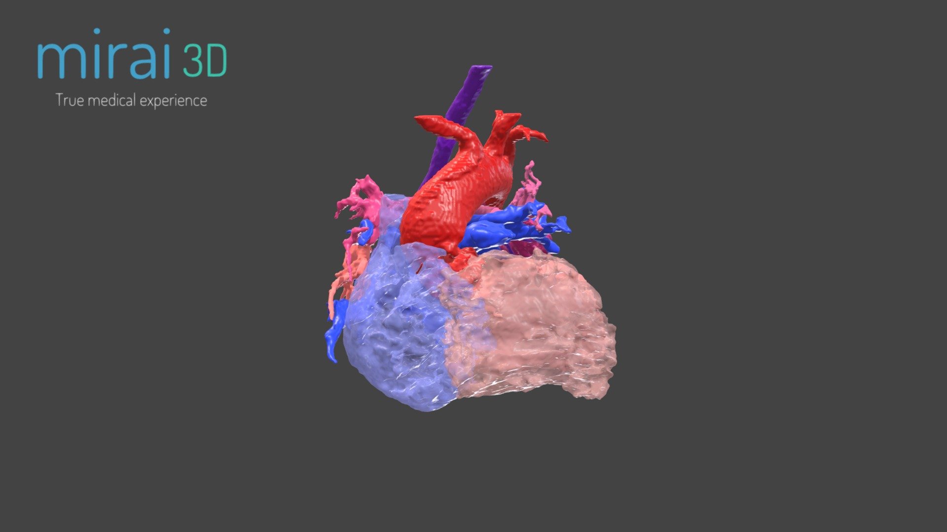 3D pediatric cardiac model for surgical planning - 3D model by MIRAI3D ...
