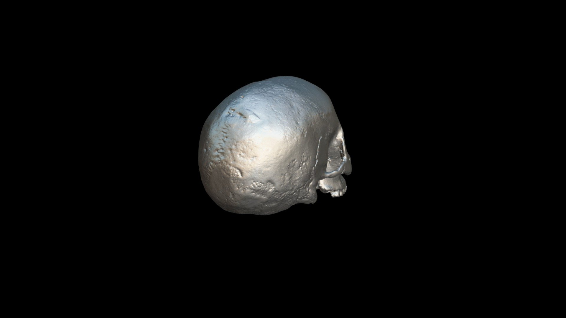 Skull - pathology - 3D model by ArcheOs [9bef4f7] - Sketchfab
