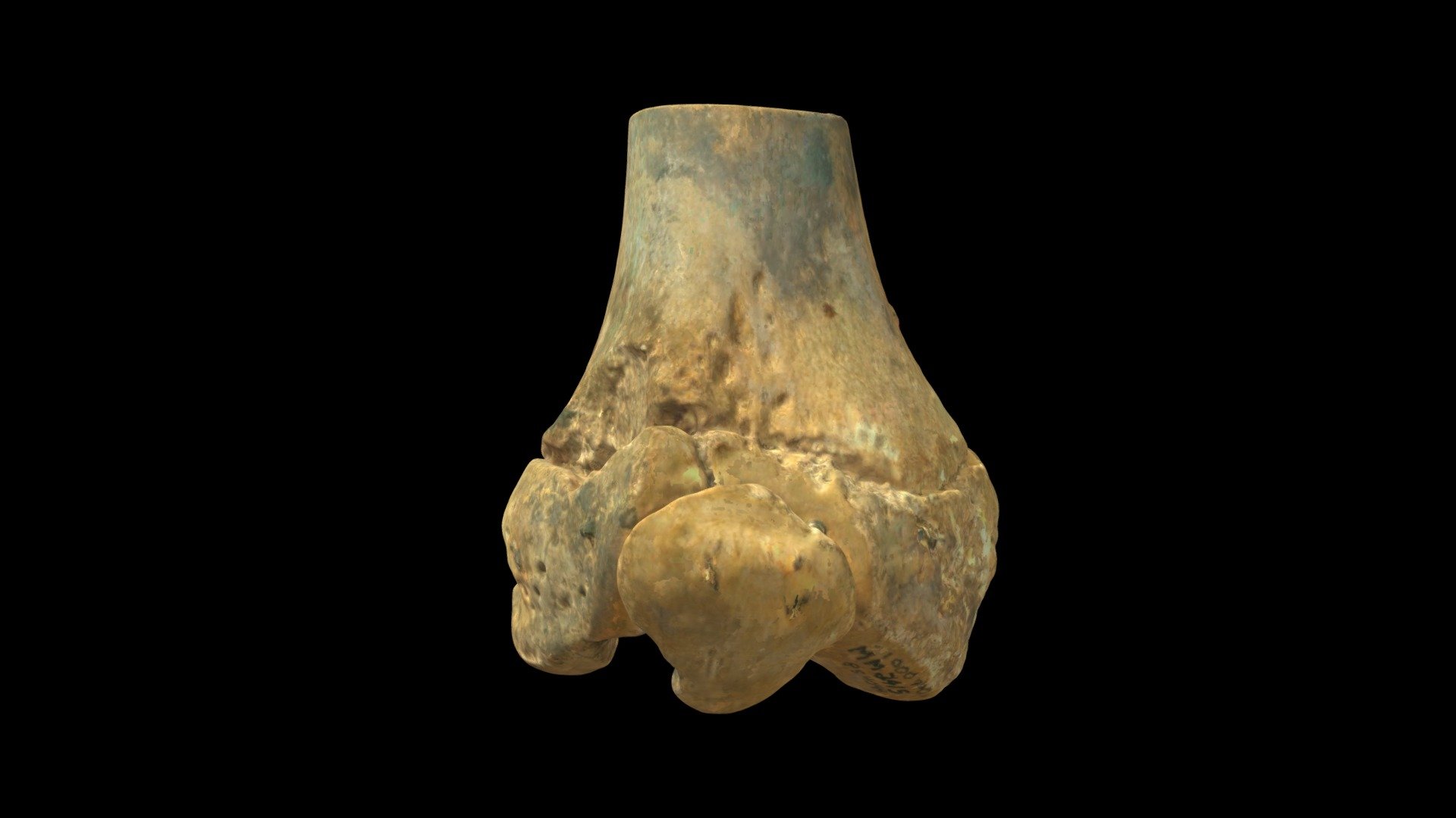 R distal femur w GSW (VCU_3D_4021) - 3D model by Virtual Curation Lab ...