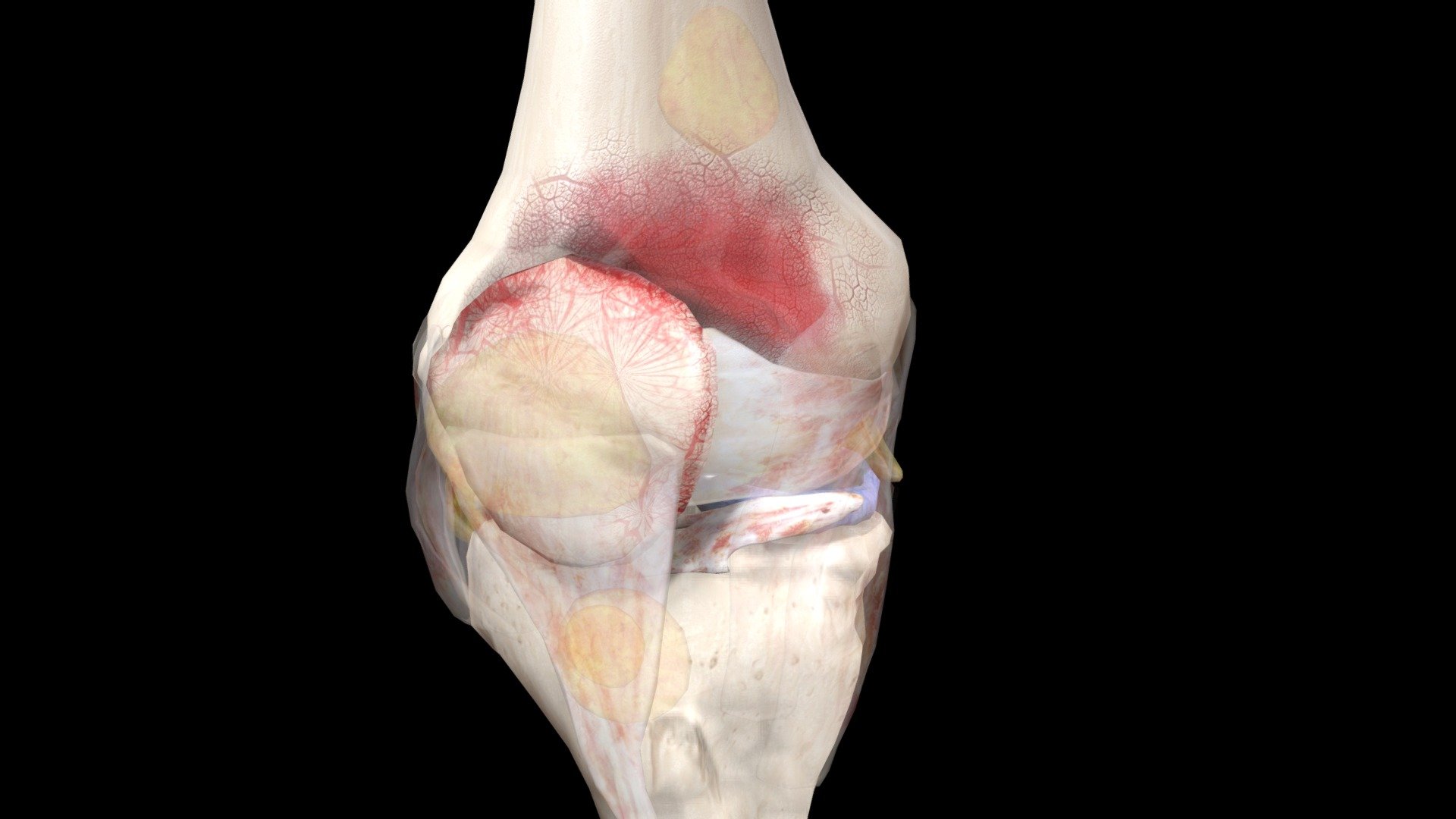 Anterior Knee Pain: Patella Femoral Syndrome - 3D model by Connections ...