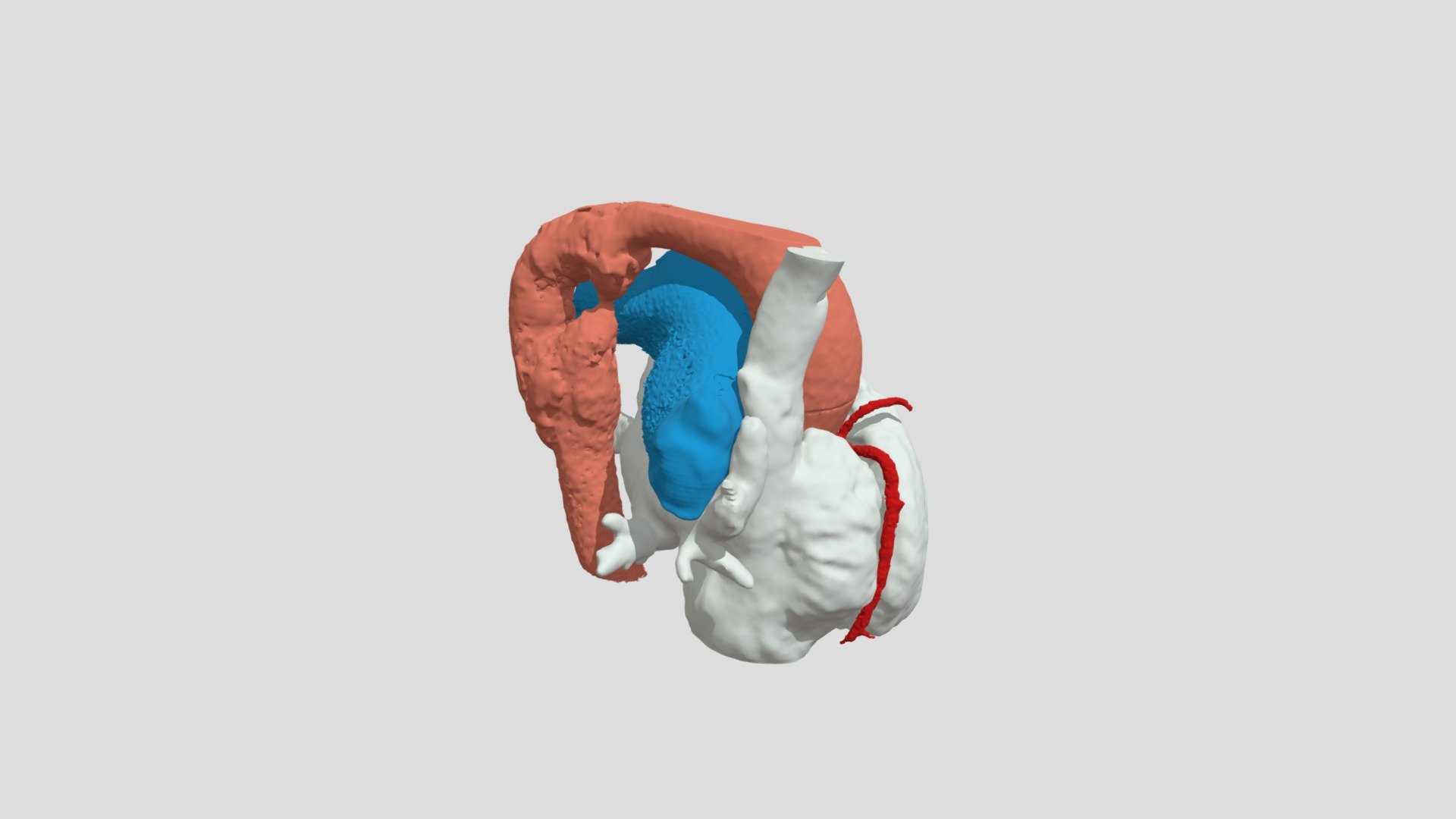 Tetralogy of Fallot, aortic coarctation (S0322) - 3D model by NCH ...