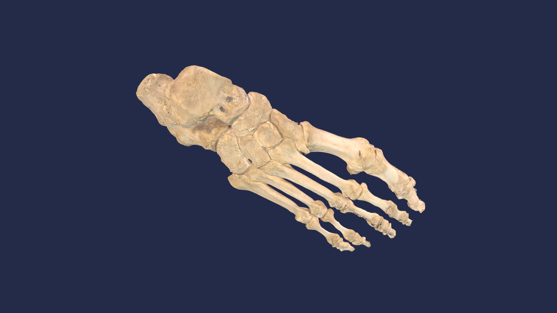 Fuß rechts - Sporn am Os cuneiforme mediale - 3D model by ...