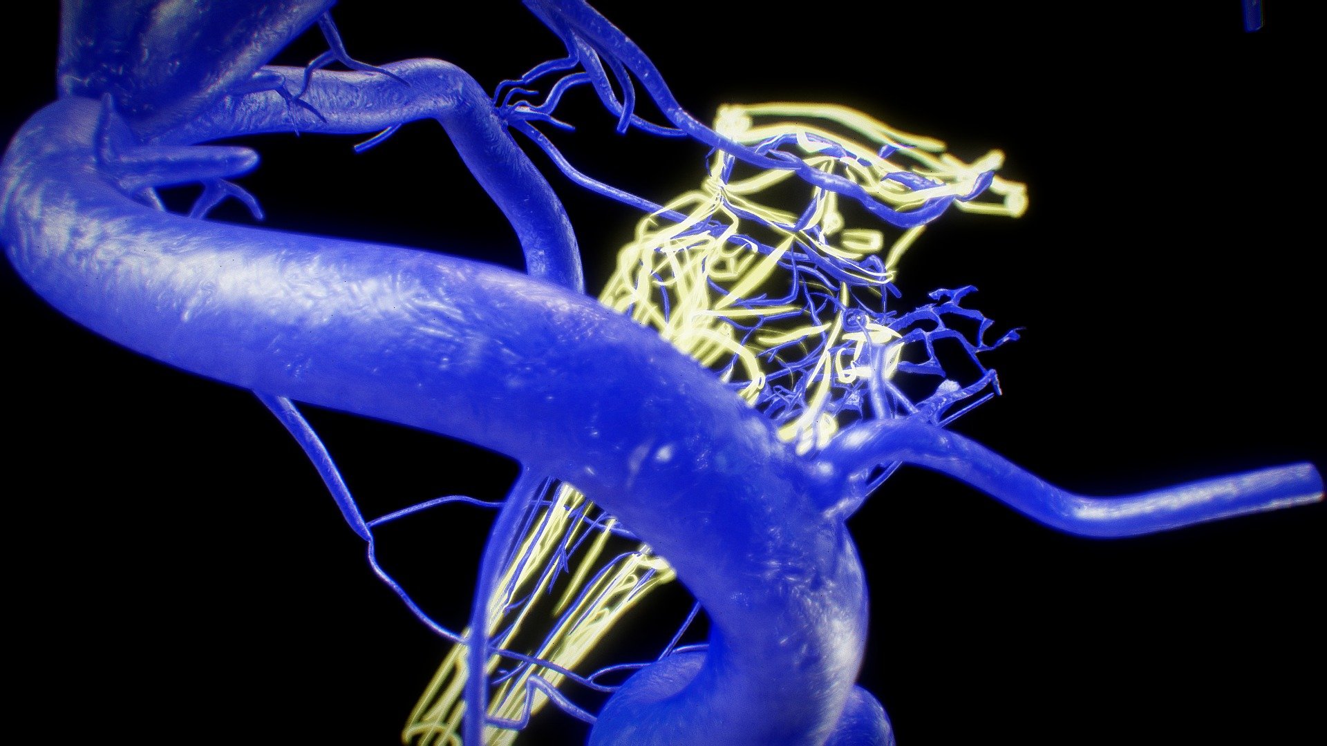 Model 1. Venous Drainage - Infratentorial DAVFs - 3D model by SBCVL ...