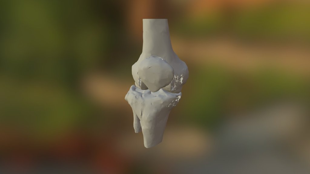 Knee - Proximal Tibia Fracture sku 054 - 3D model by orto3d [9f2b273 ...