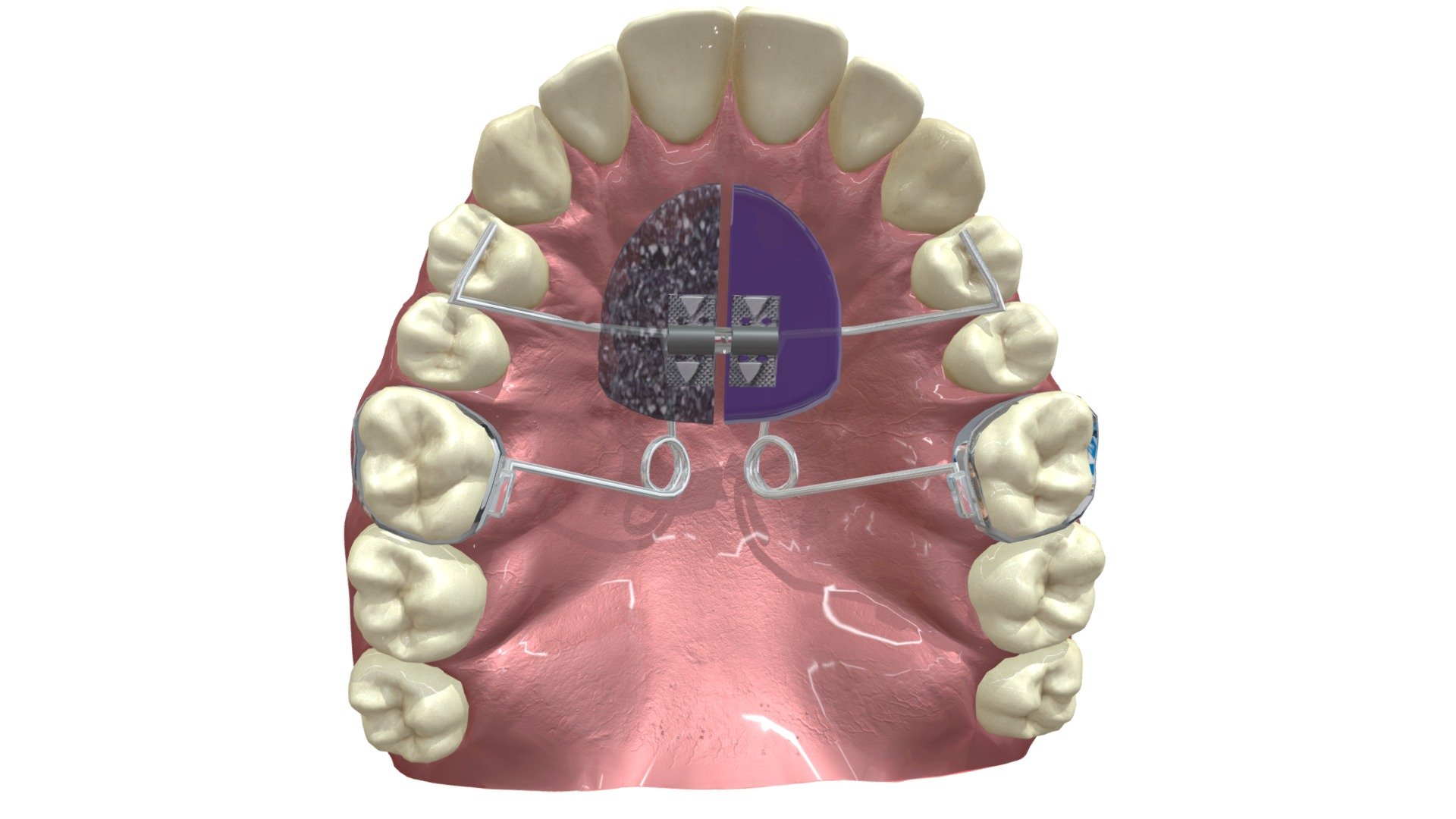 3. PENDEX DISTALIZER - 3D model by Interactive 3D Data ...
