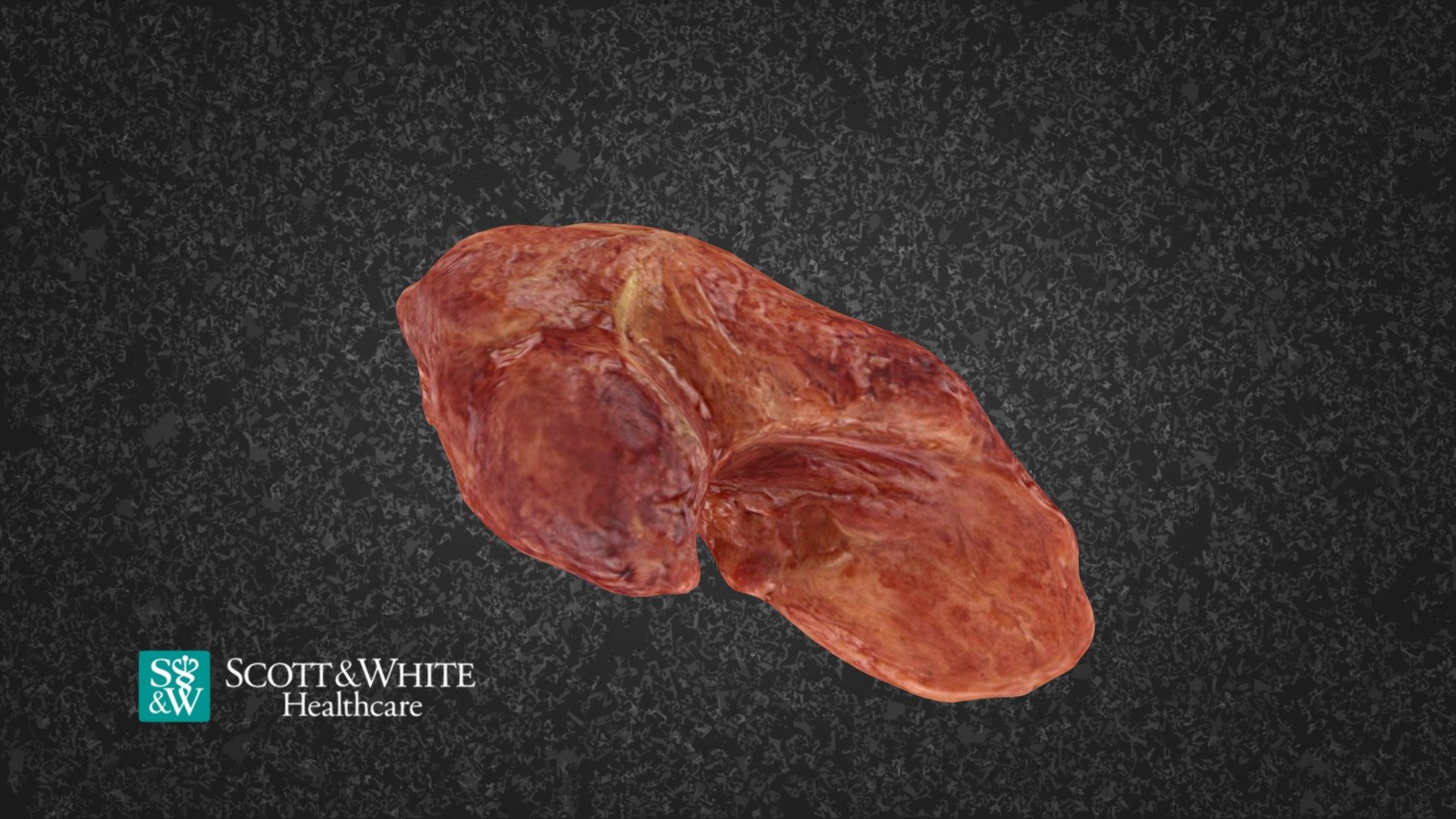 Goiter Showing Hemorrhage 154754 - 3D model by Scott & White Moulage ...
