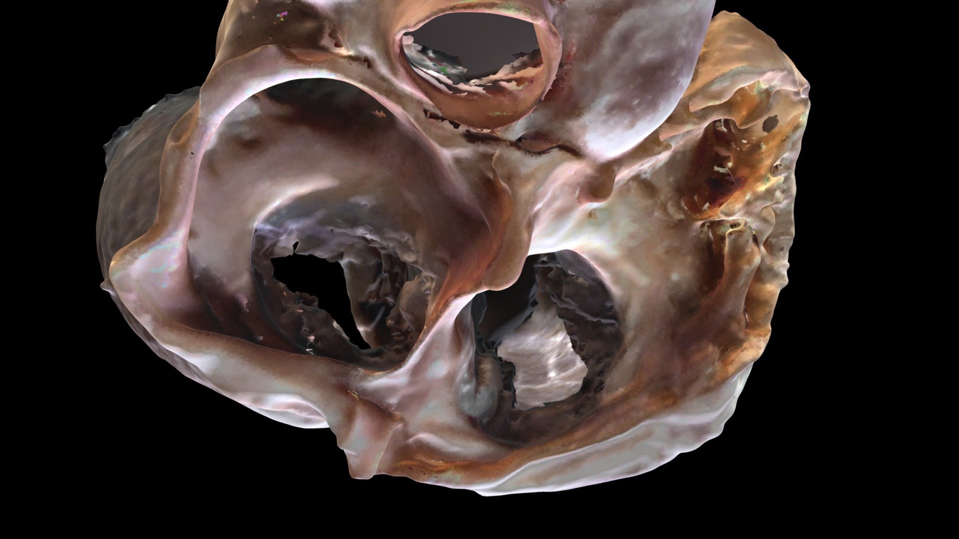 Cleft mitral valve and perimembranous vsd I-839 - 3D model by Rohit ...