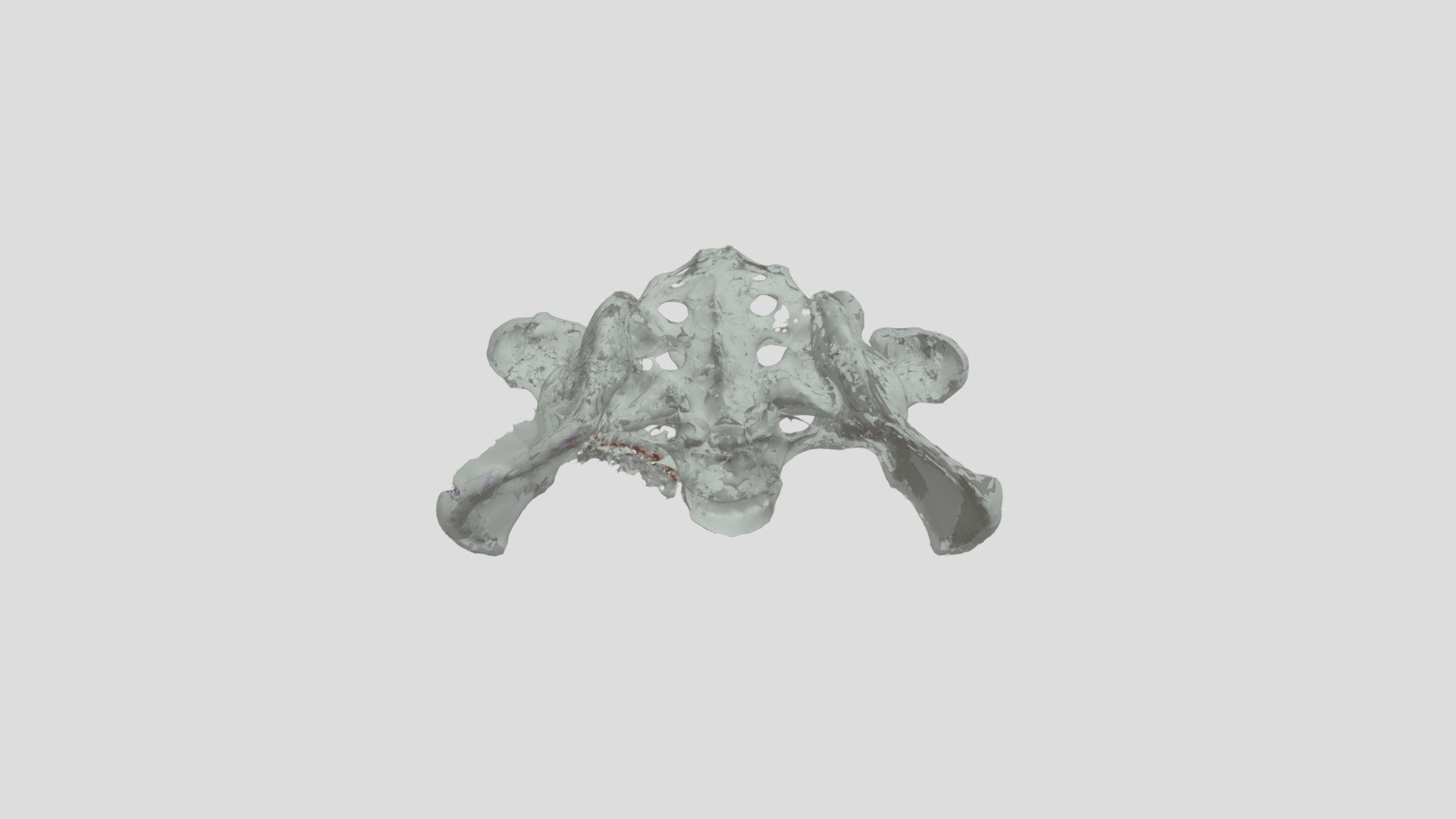 Fractured Pelvis + Hardware Segmentation - 3D model by mademsmith ...