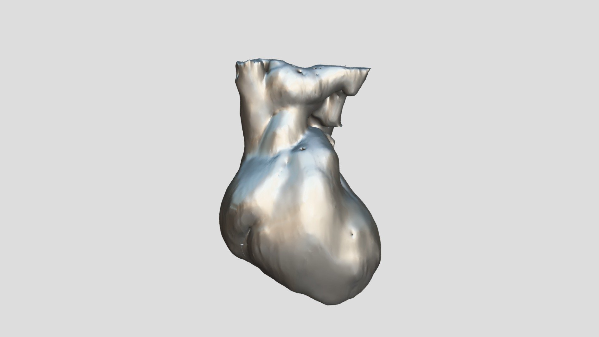 Partial Anomalous Pulmonary Venous Return - 3D model by Ainsley (@swainsley) [a2f4007] - Sketchfab
