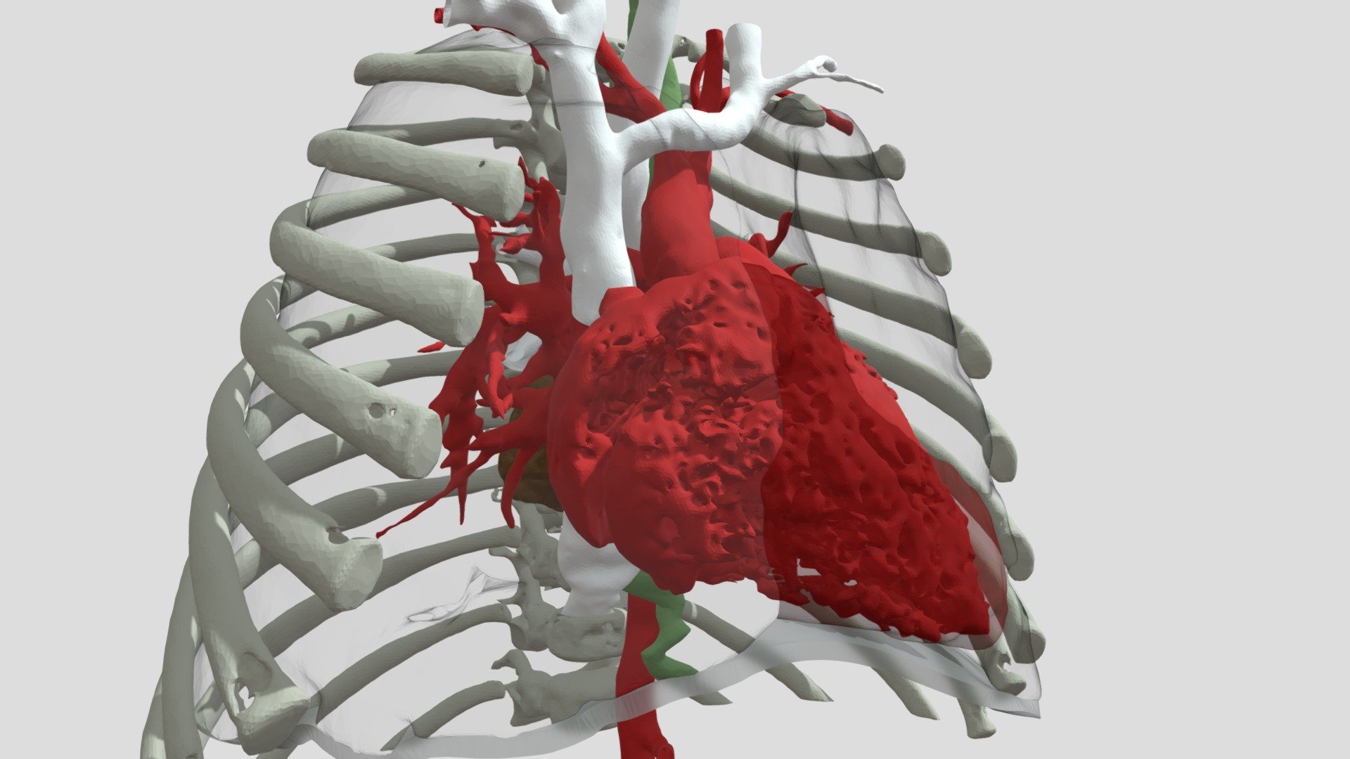 CHIRPED06KD06022023_massa esofago_03 - 3D model by 3Dsurgery [a30b971 ...
