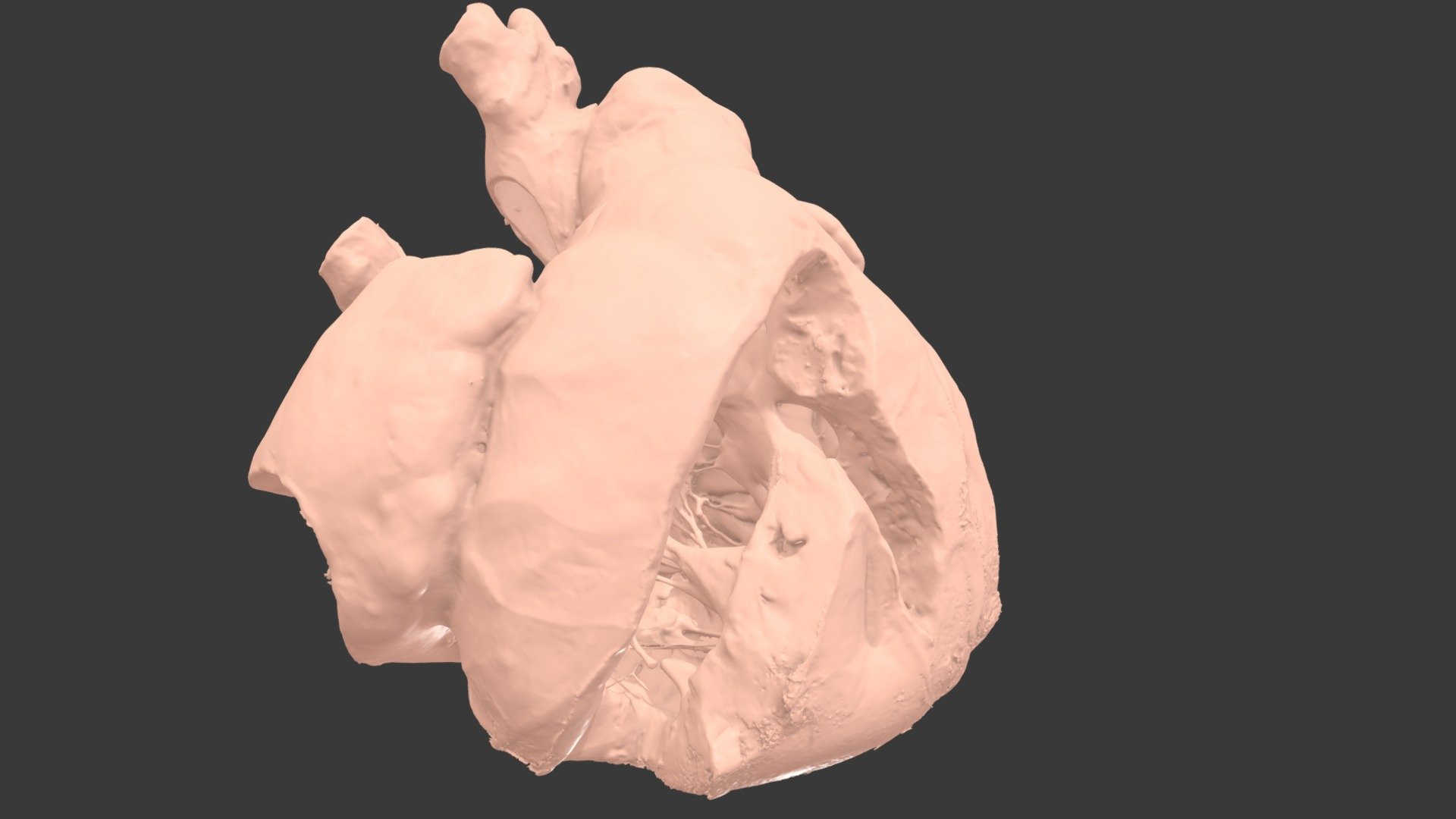 ASD #5 - {S,D,S} with PDA, ASD 2, PLSVC to CS - 3D model by heartmodels ...