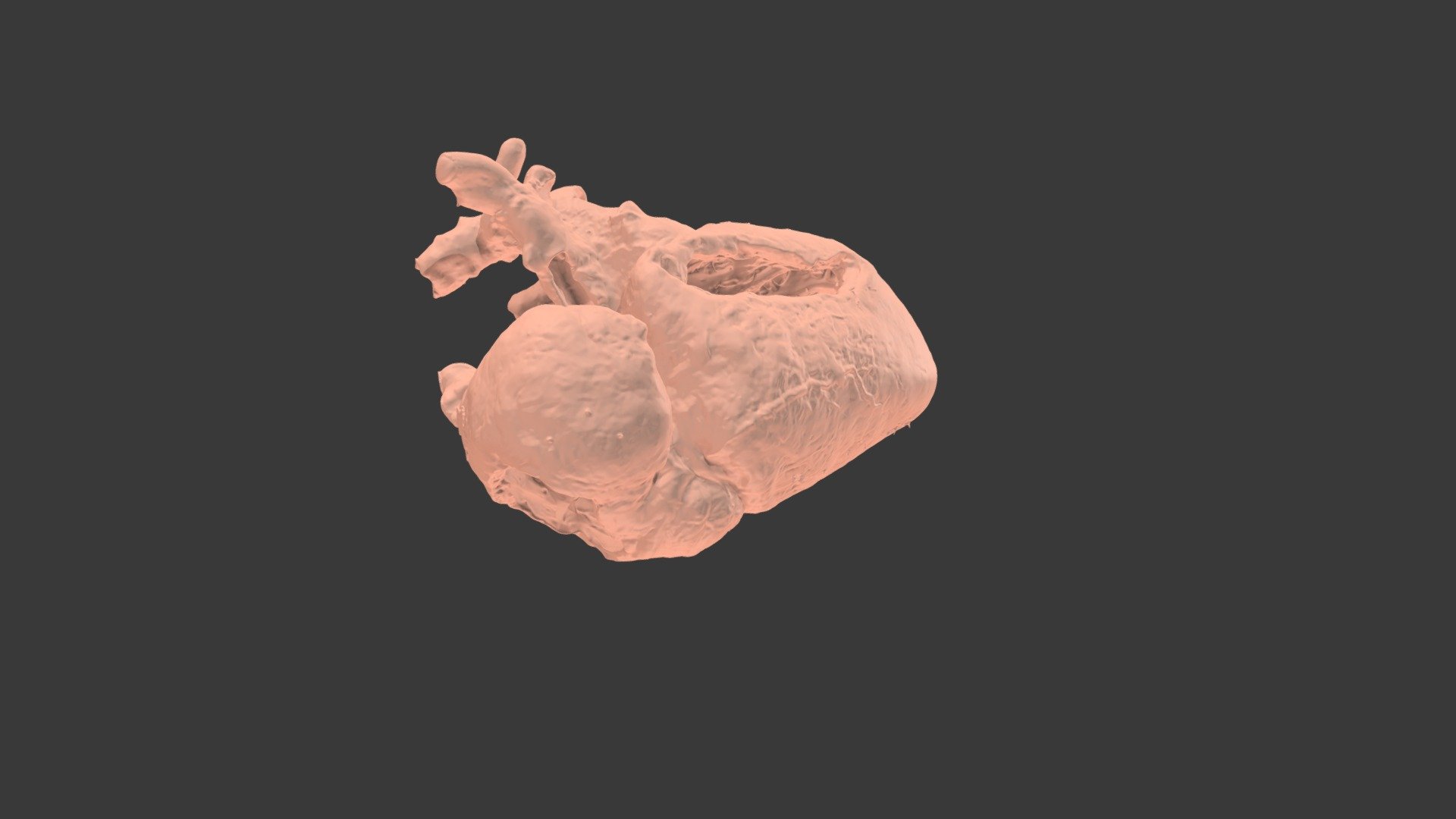 CAVC #5 - {S,D,S} with Complete CAVC (Type A) - 3D model by heartmodels ...