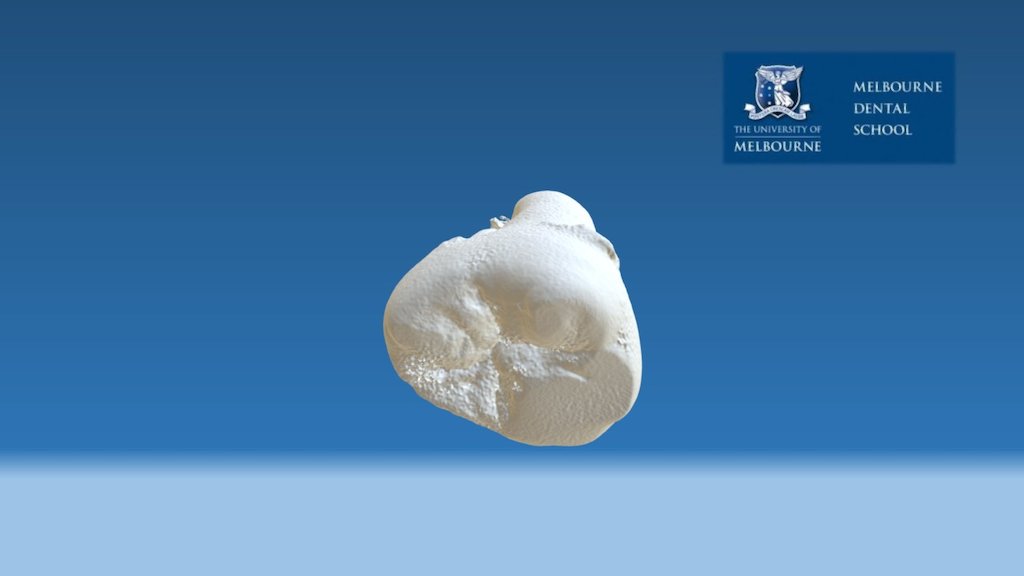 Molar with attrition - Download Free 3D model by Melbourne Dental ...