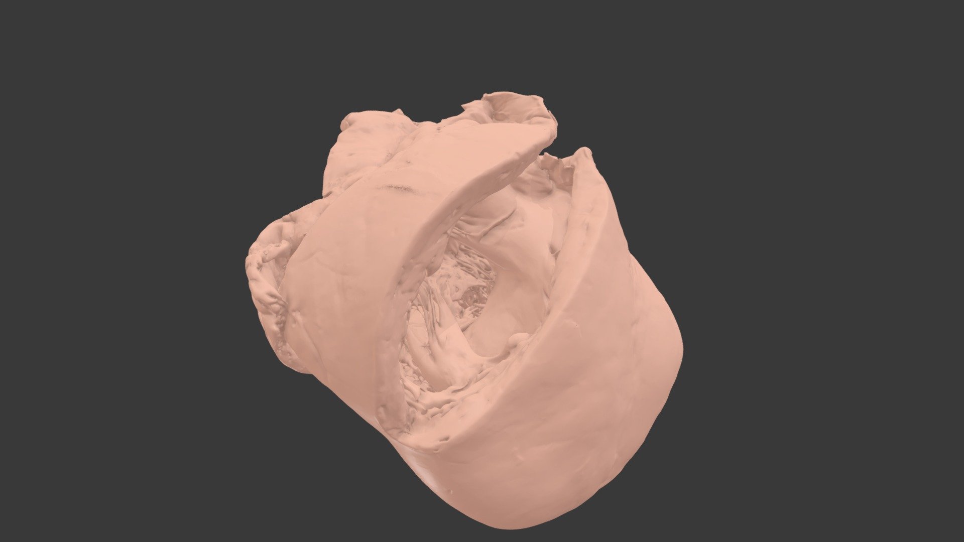 CAVC #7 - Complete CAVC (type C), ASD, PLSVC - 3D model by heartmodels ...