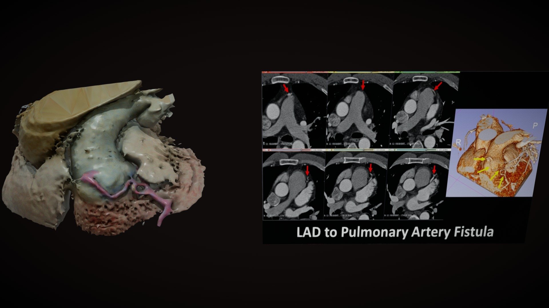 LAD to Pulmonary Artery Fistula - Download Free 3D model by tl0615 ...