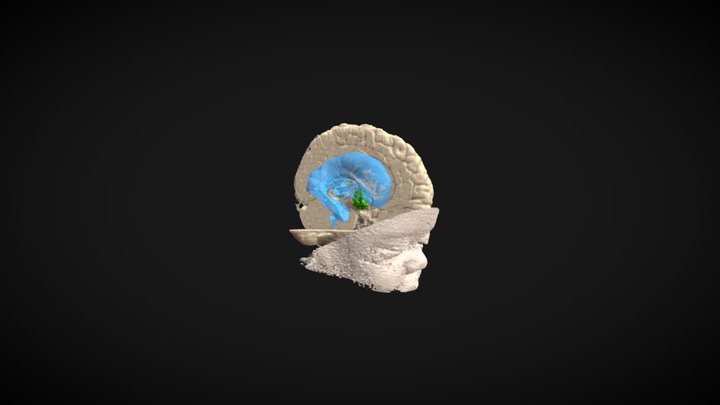 Neurosurgery 3D models - Sketchfab