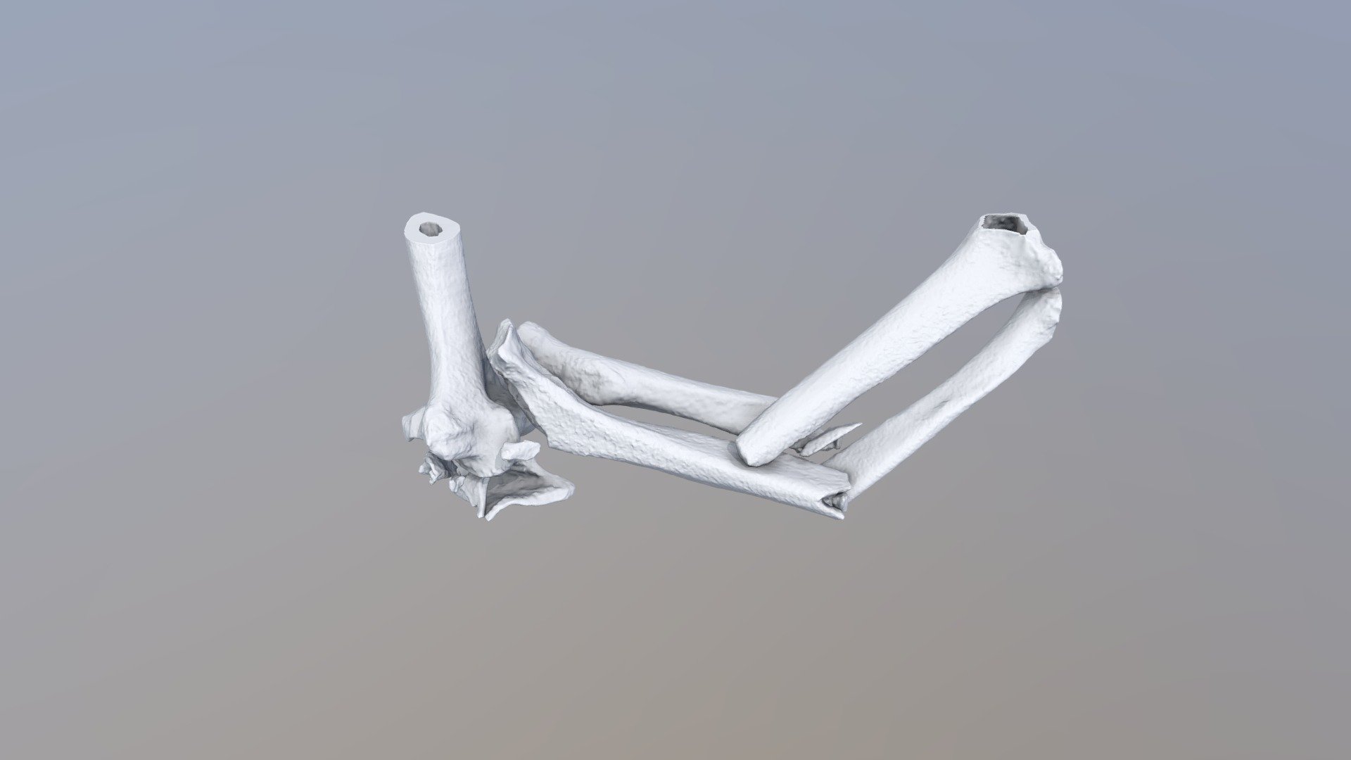 Forearm shaft fracture - 3D model by Innowise: 2D/3D Design and ...