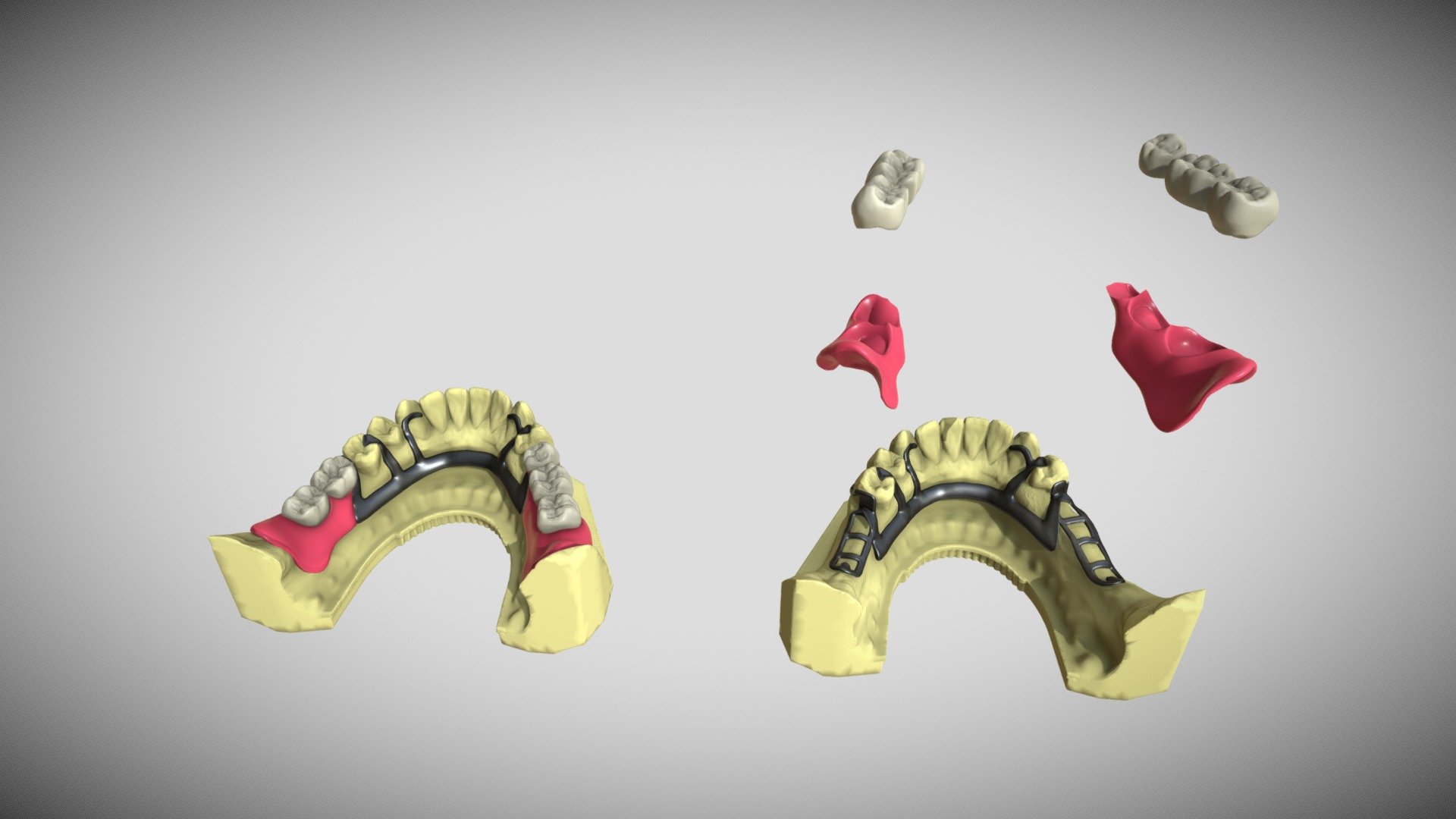 Kennedy Class I Design (Lower) - 3D model by Muhammad Nabeel ...